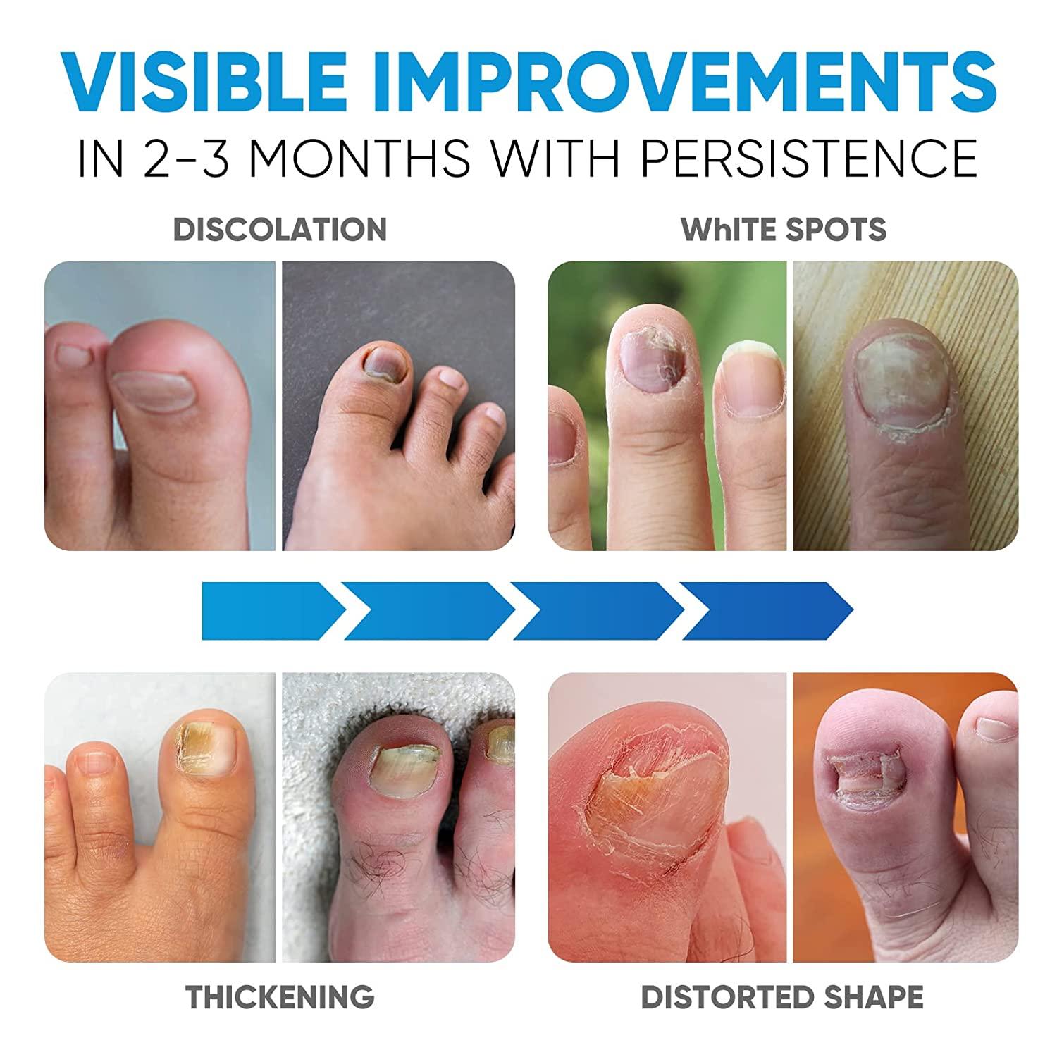 Advanced Nail Fungus Cleaning Laser Treatment Device - Home Use Toenail ...