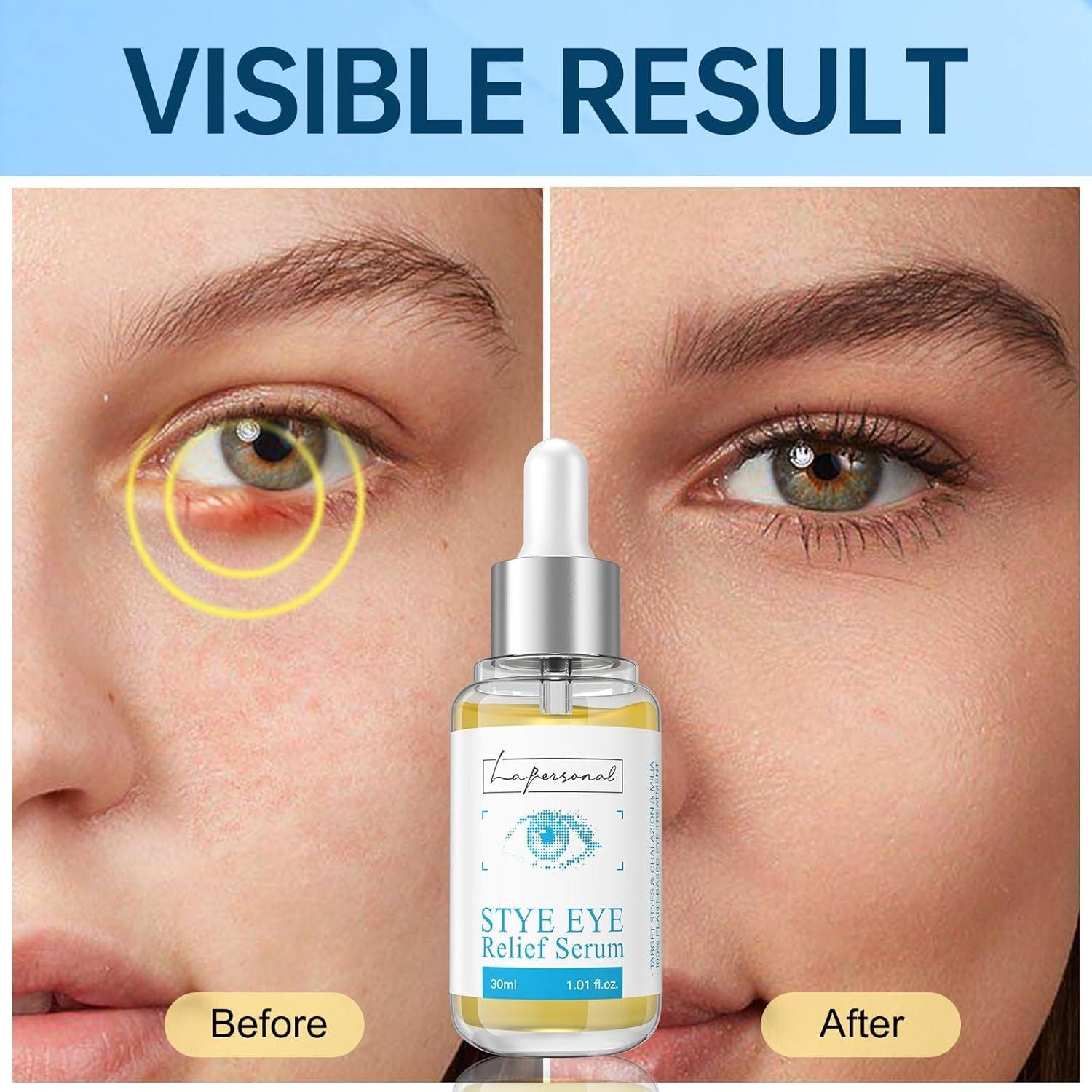 Stye Eye Serum 30ml | Vegan Relief for Styes Chalazion & Blepharitis ...