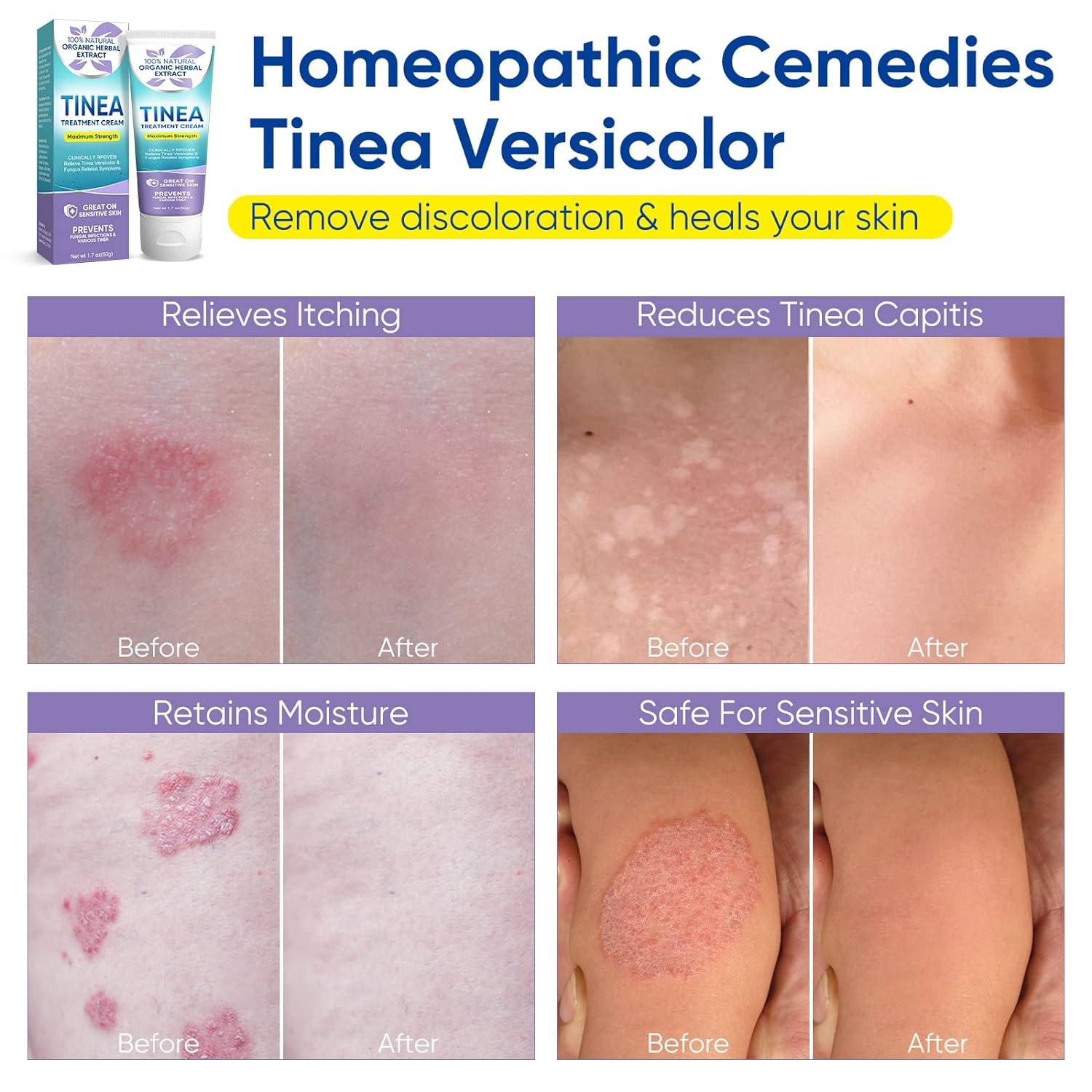 Tinea Versicolor Natural Skin Cream - Effective Treatment for All Skin ...