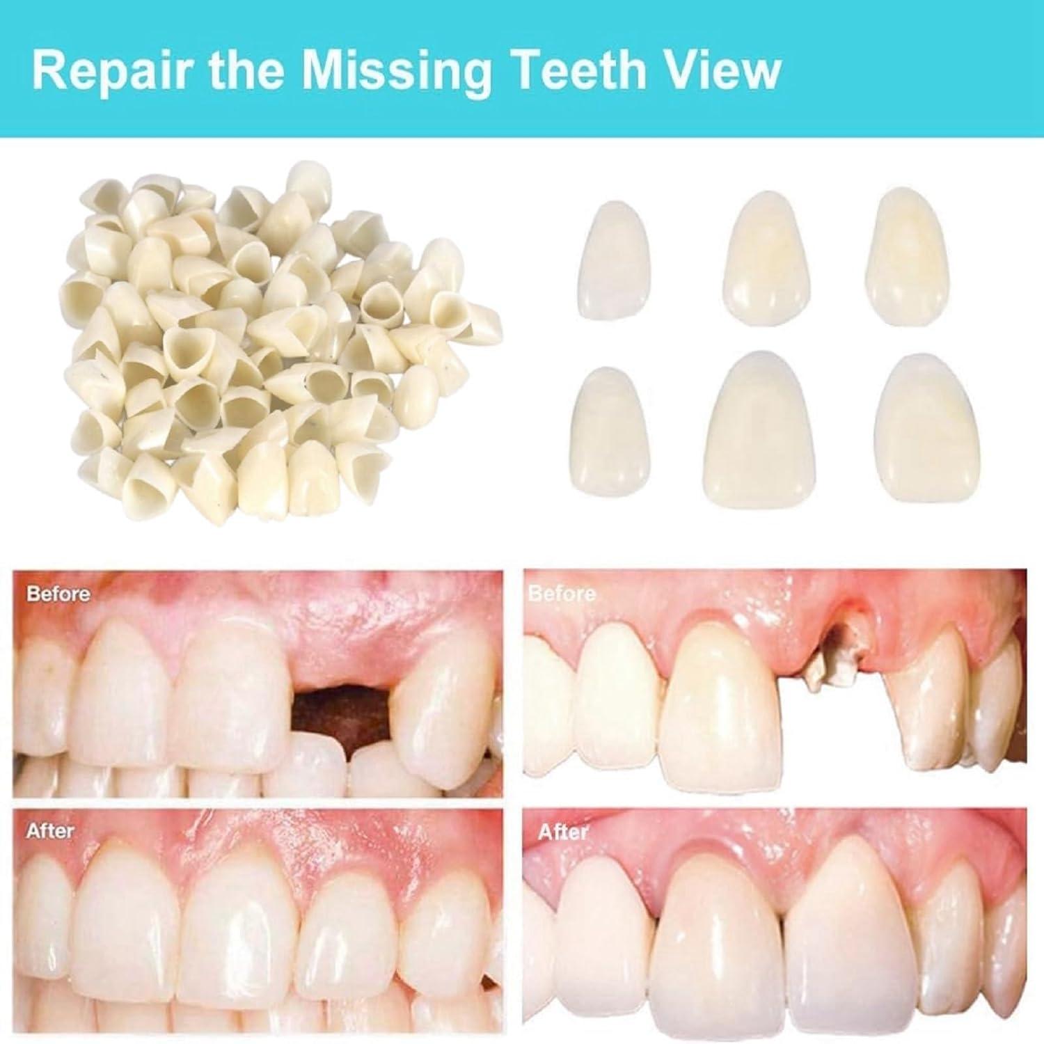 70PCS Tooth Repair Kit - Temporary Tooth Crown Replacement - Denture ...