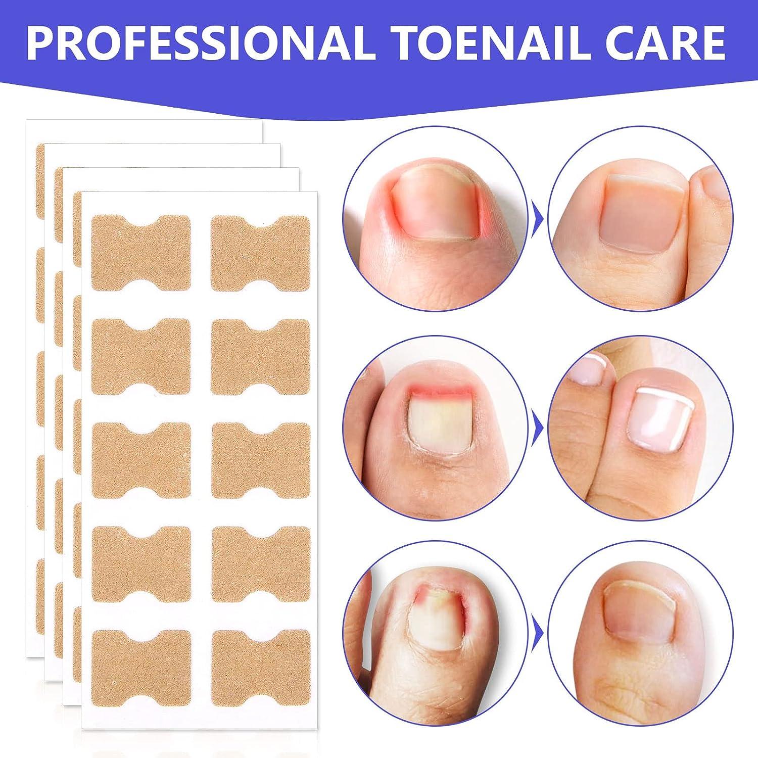 100PCS Ingrown Toenail Corrector Strips - Painless Toenail Correction ...