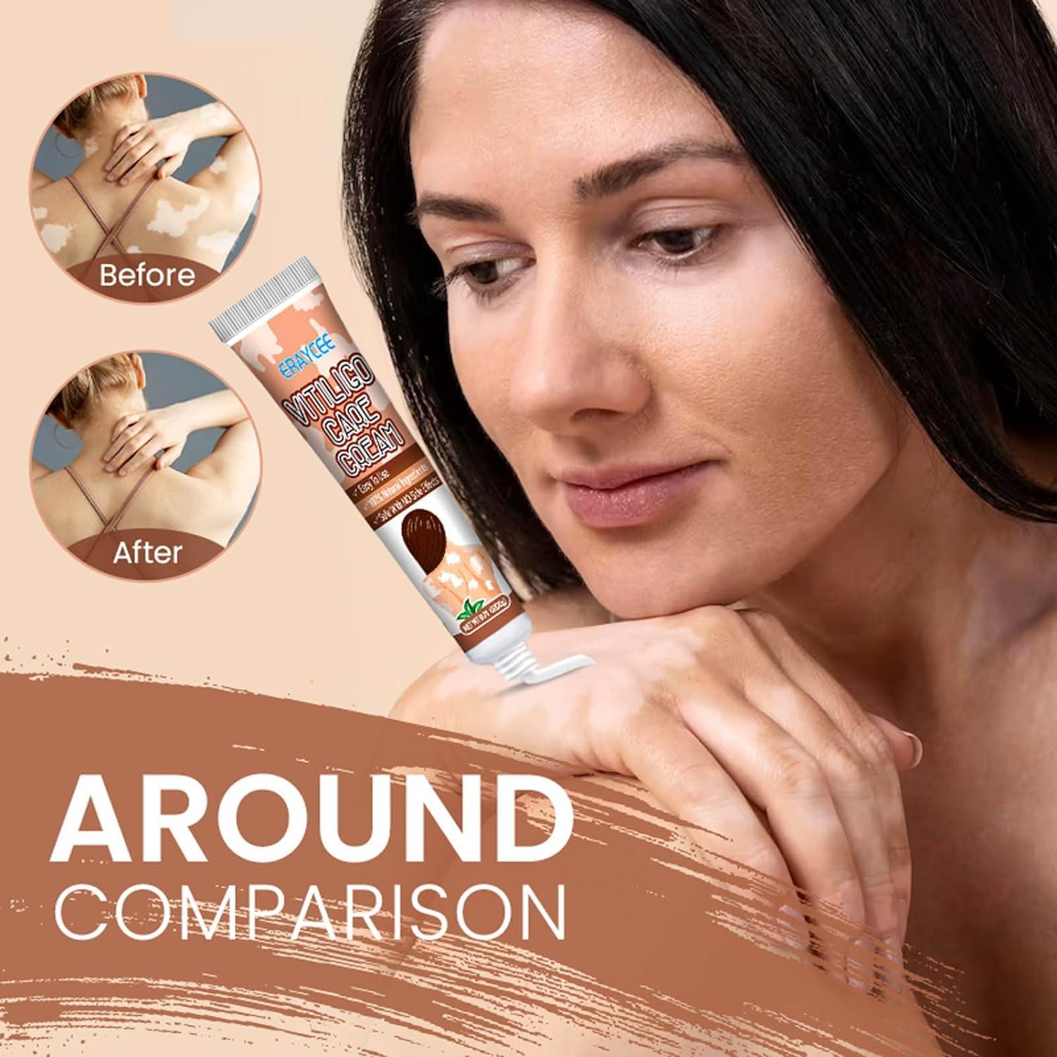 Vitiligo Care Ointment 20g | Repigmentation & Relief Cream | Improves ...