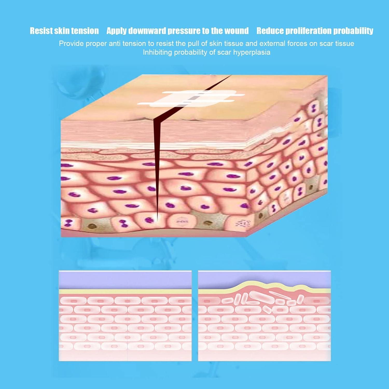 Raguso Zip Stitch Sutures: Noninvasive Skin Closure Device - Waterproof ...