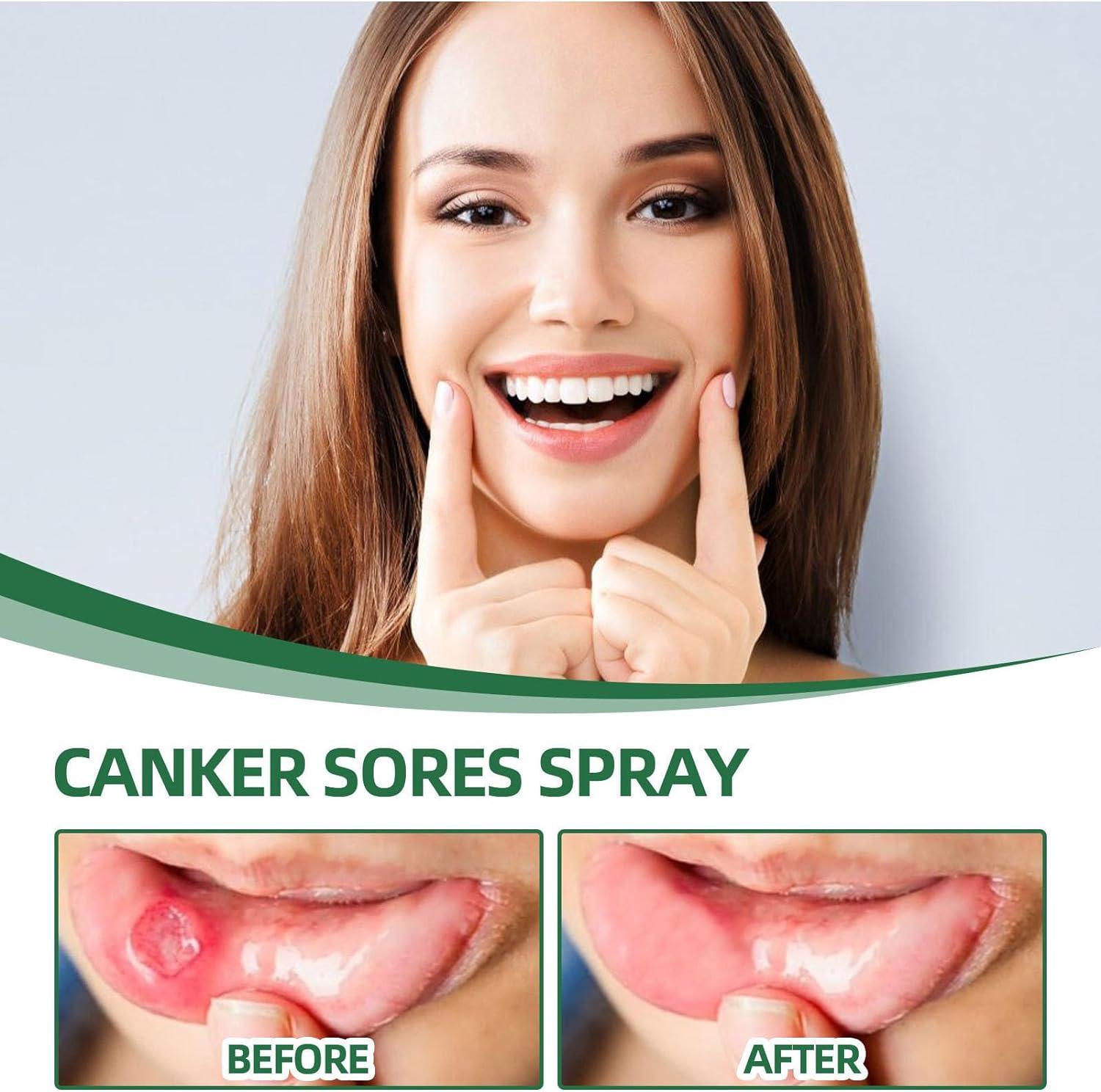 Oral Ulcer Relief Spray 20ml - Canker Sore & Gum Pain Relief Treatment ...