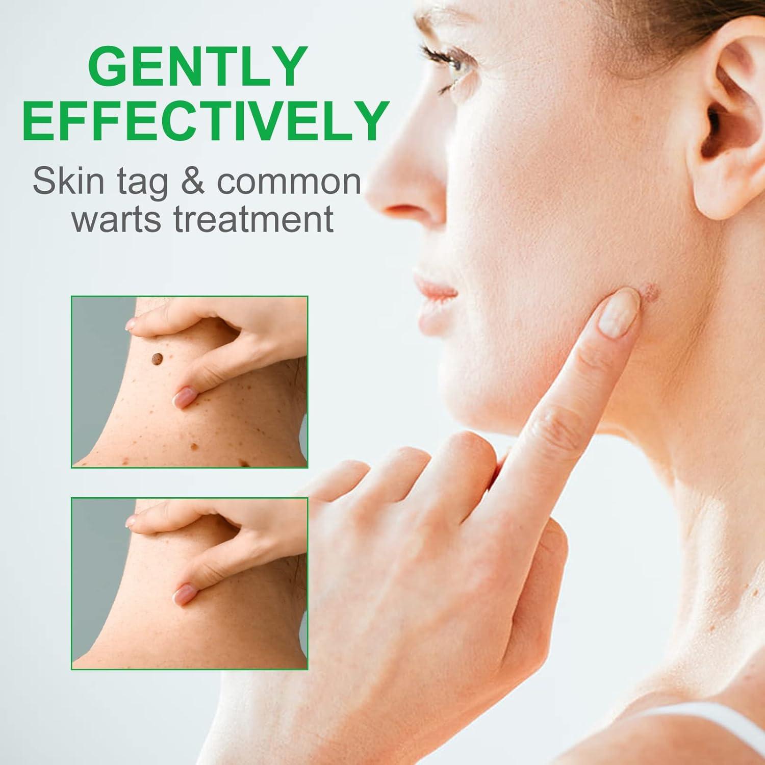 GNAPY Skin Tag & Wart Remover Cream - Natural Treatment Formula for ...
