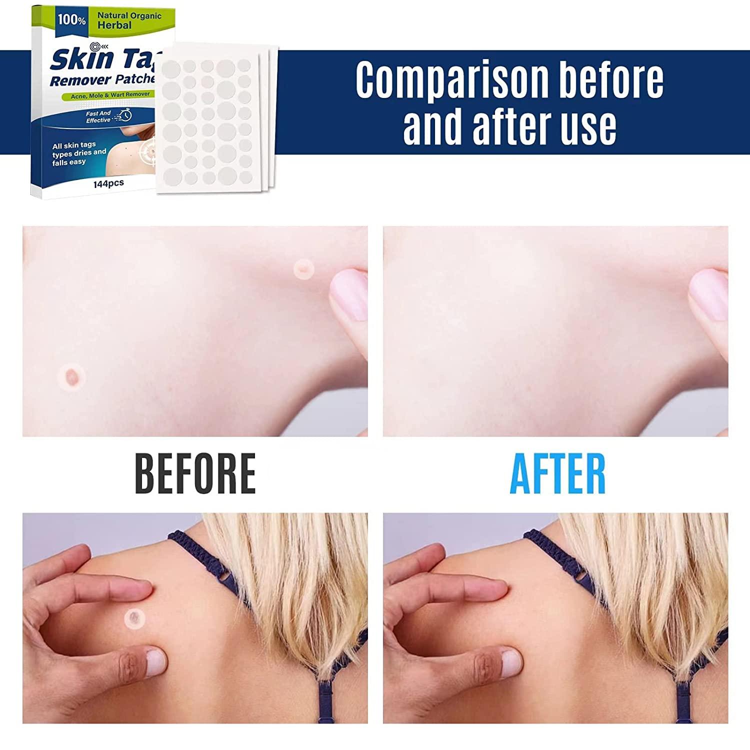 Skin Tag Remover Patch 144 PCS | Safe & Effective Skin Tag Removal Patches | 144 pcs/box | Buy ...