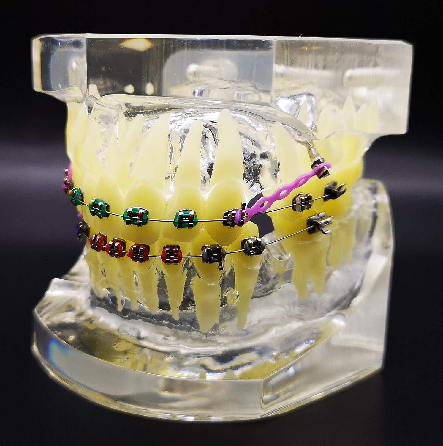 Dental Typodont Orthodontic Teeth Model with Metal Braces & Ligature ...