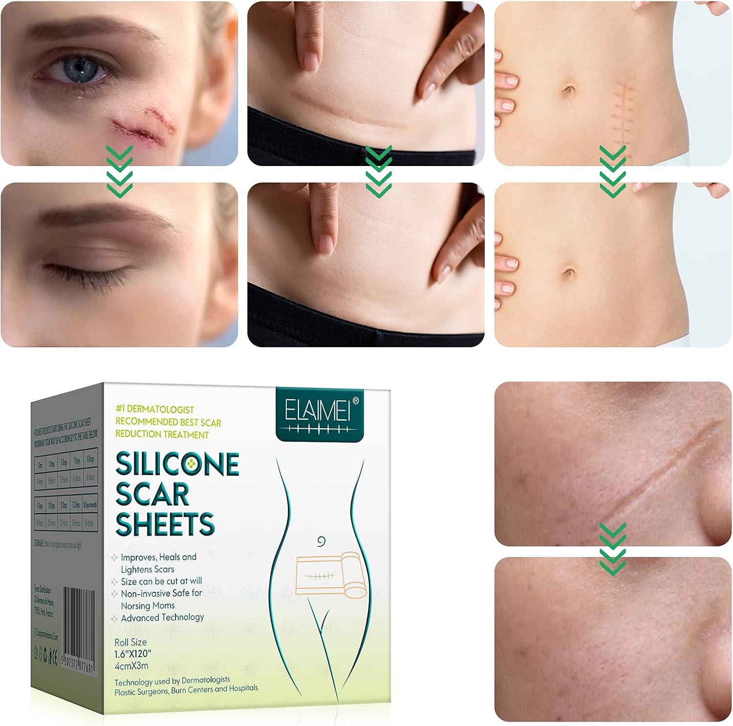 Silicone Scar Removal Foils - Effective Flattening for Surgery Burns ...