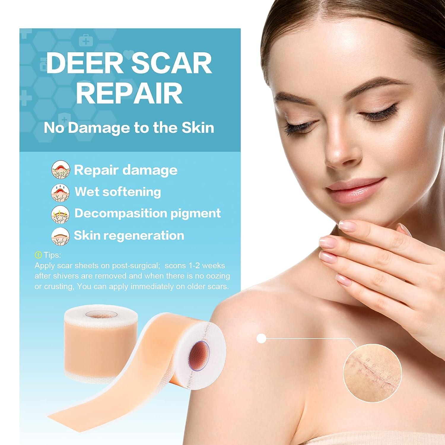 Medical Grade Silicone Scar Sheets Roll - 1.6 x 120 inches, 3M Brand ...