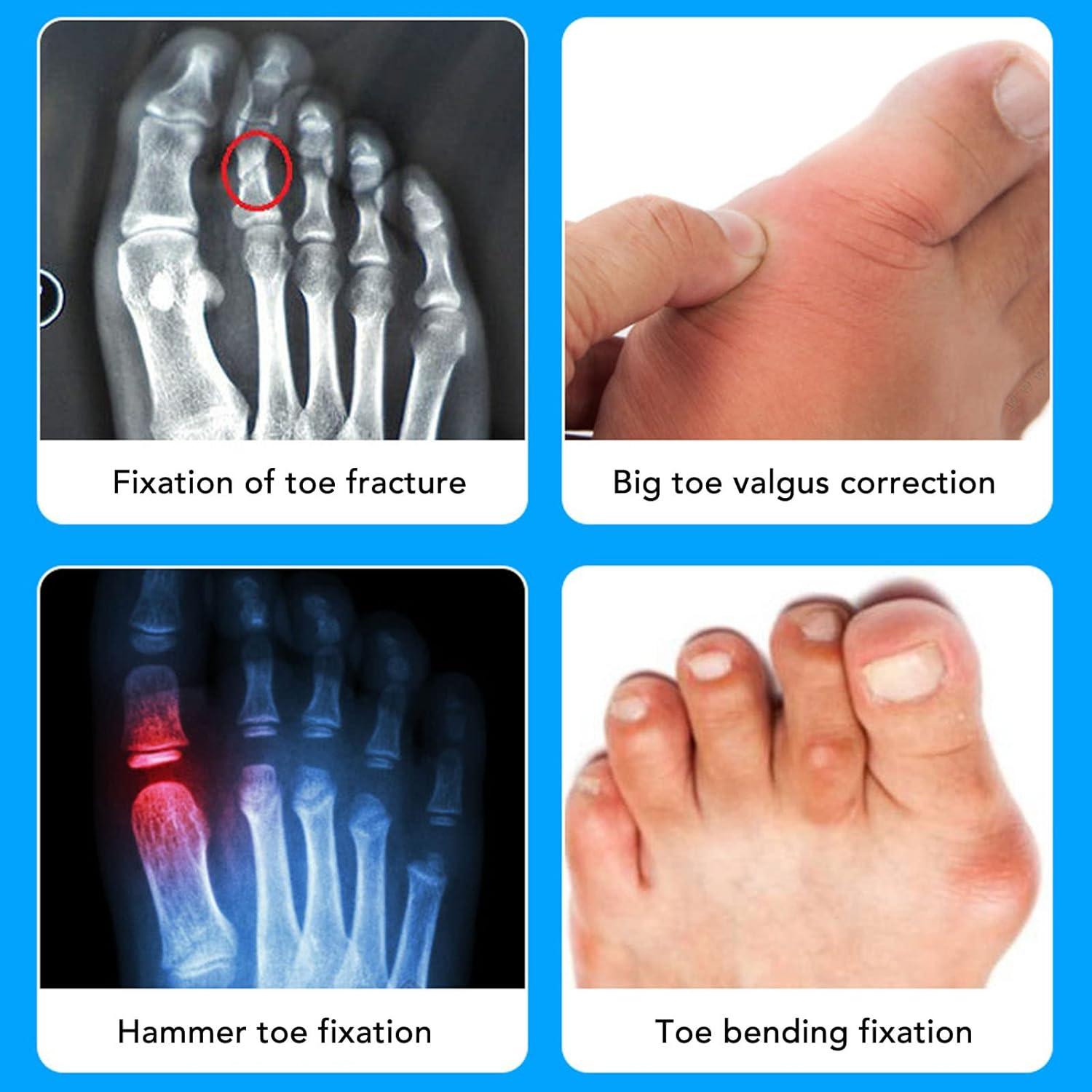 TMISHION Hammer Toe Straightener - Cushioned Bandage for Toe ...