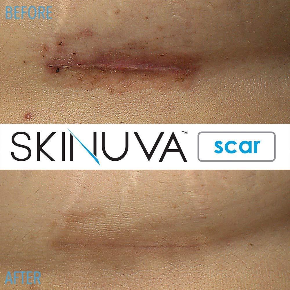 Skinuva Next Generation Scar Cream - Advanced Scar Removal with Growth ...