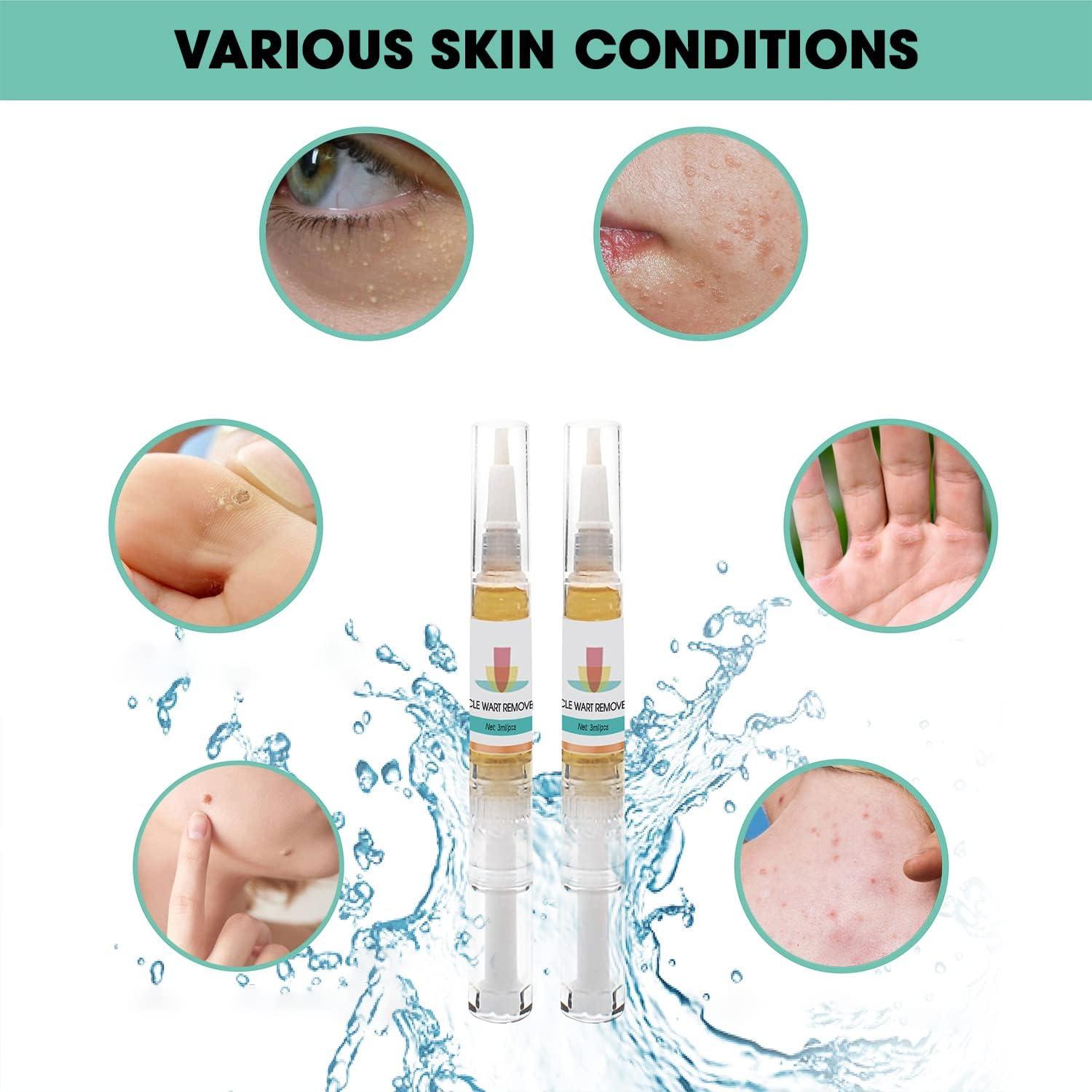 Wart Remover Pens - Natural & Safe Treatment for Foot & Hand Warts ...