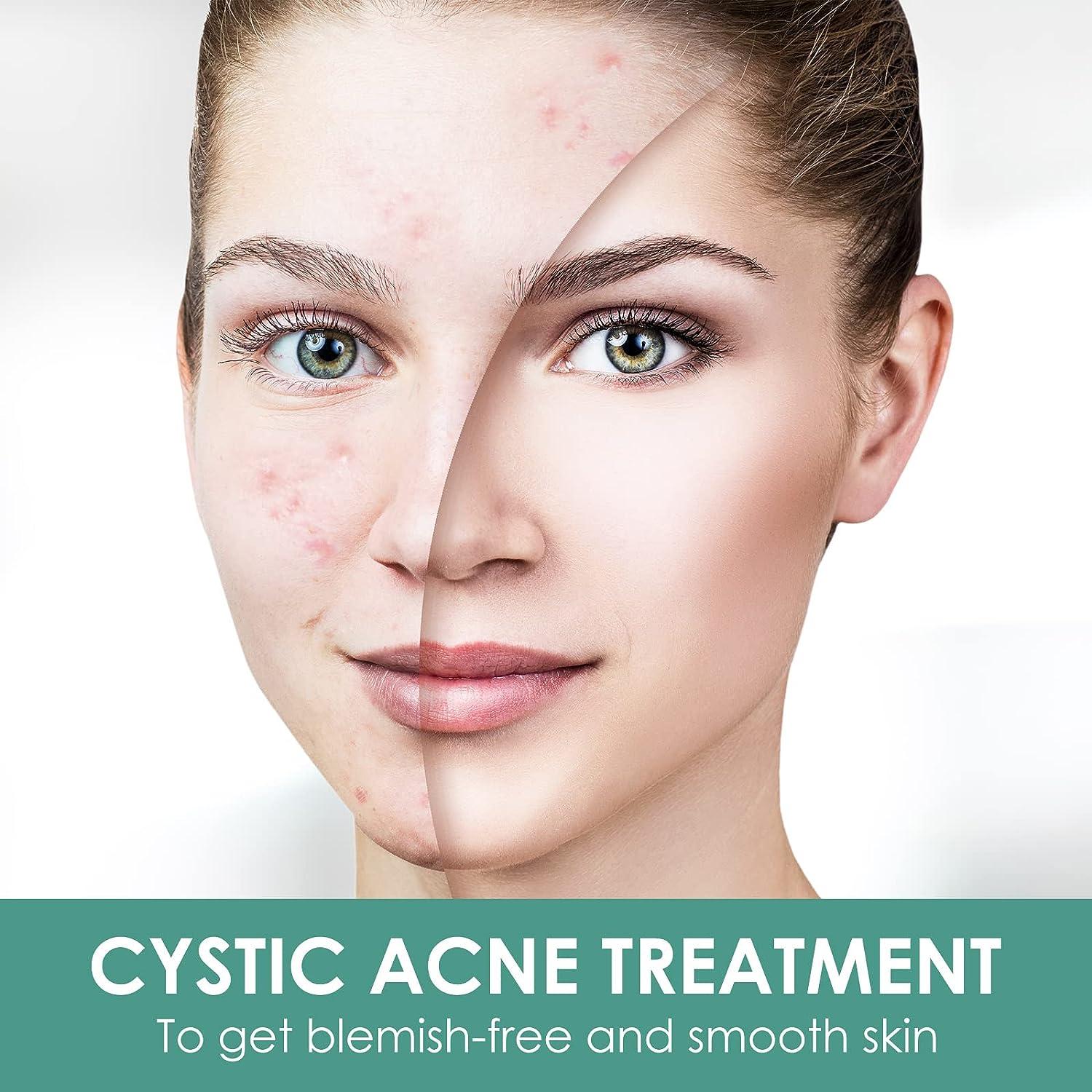 Mild Cystic Acne Cheeks