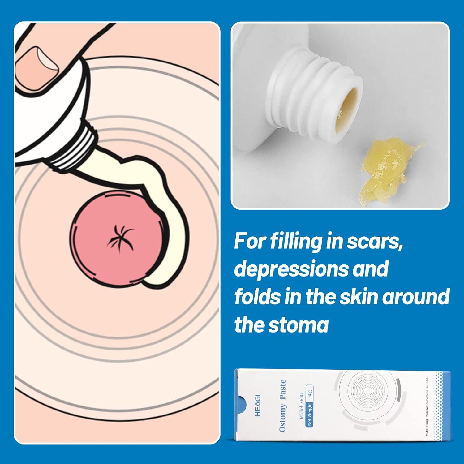 Buy Alcohol-Free Stoma Cream & Leak-Proof Accessories for Colostomy ...
