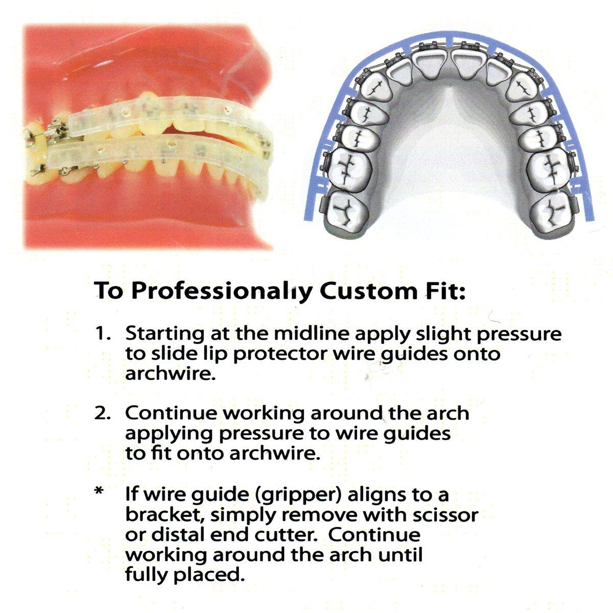 Braces Lipguard Protector Shield - Upper & Lower Teeth (1 Set) | Shop ...