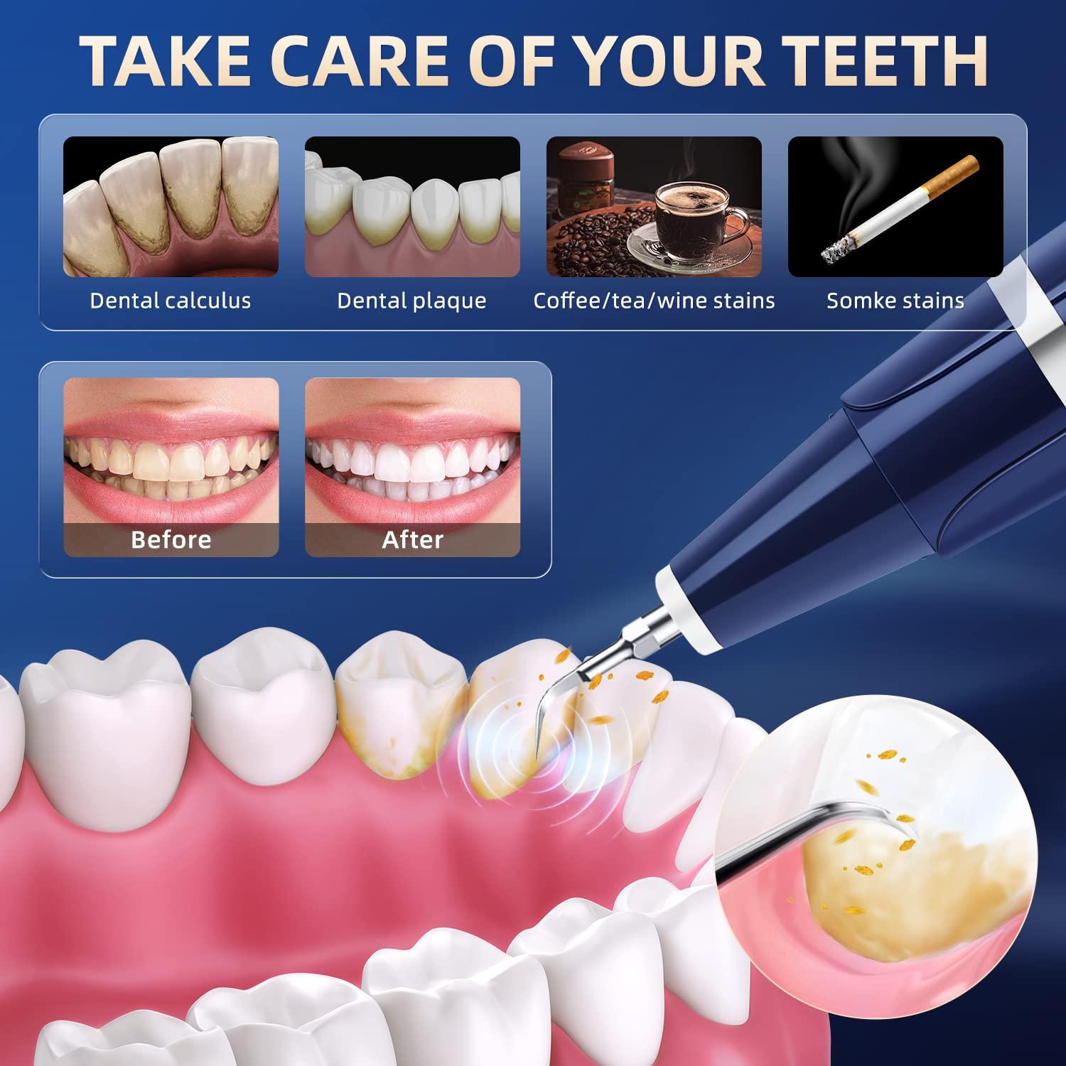 Dental Calculus Remover Teeth Cleaning Kit - Tartar and Plaque Remover ...