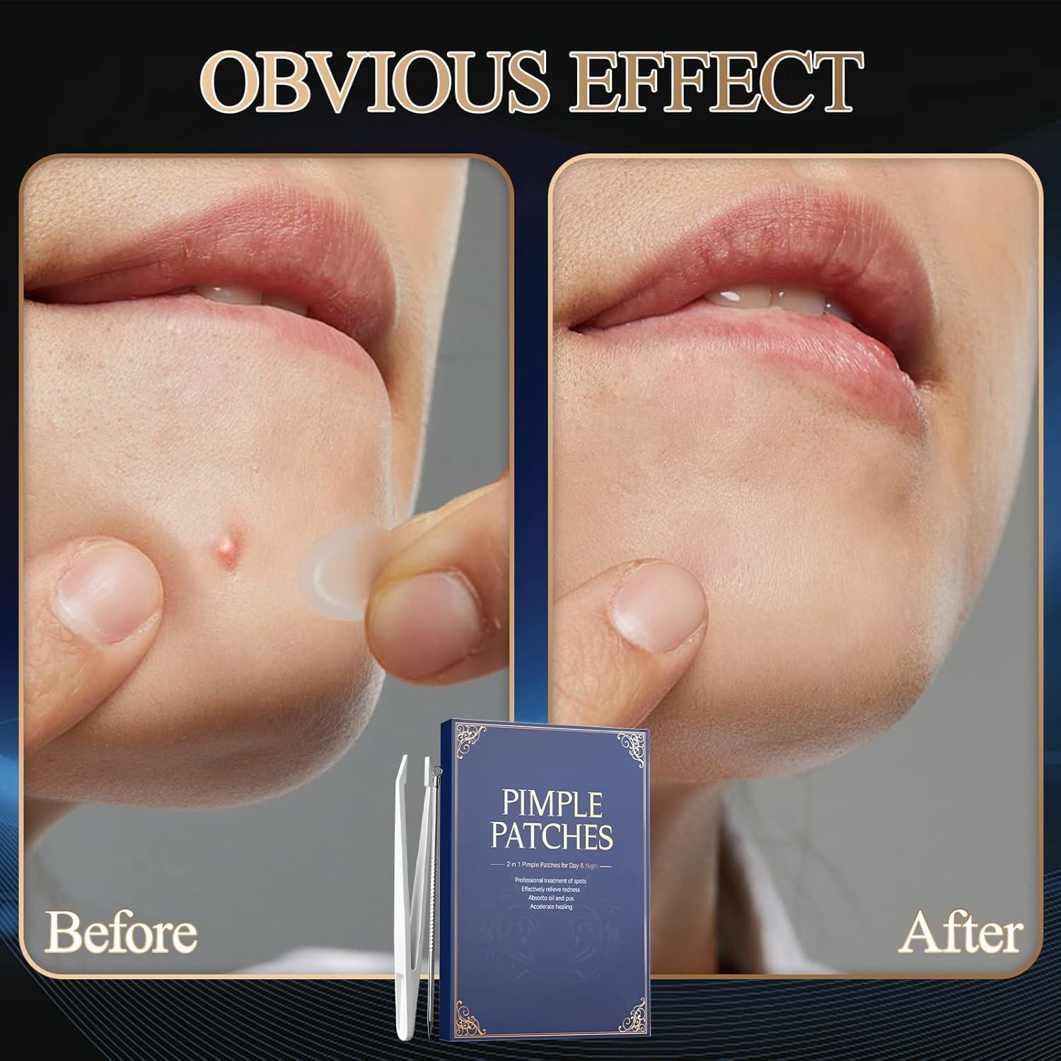 252 PCs Sugelary Pimple Patch 2-in-1 Invisible Hydrocolloid Pimple ...