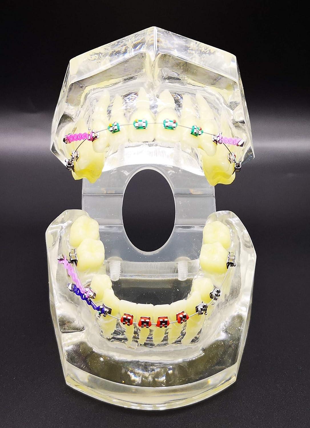 Dental Typodont Orthodontic Teeth Model with Metal Braces & Ligature ...