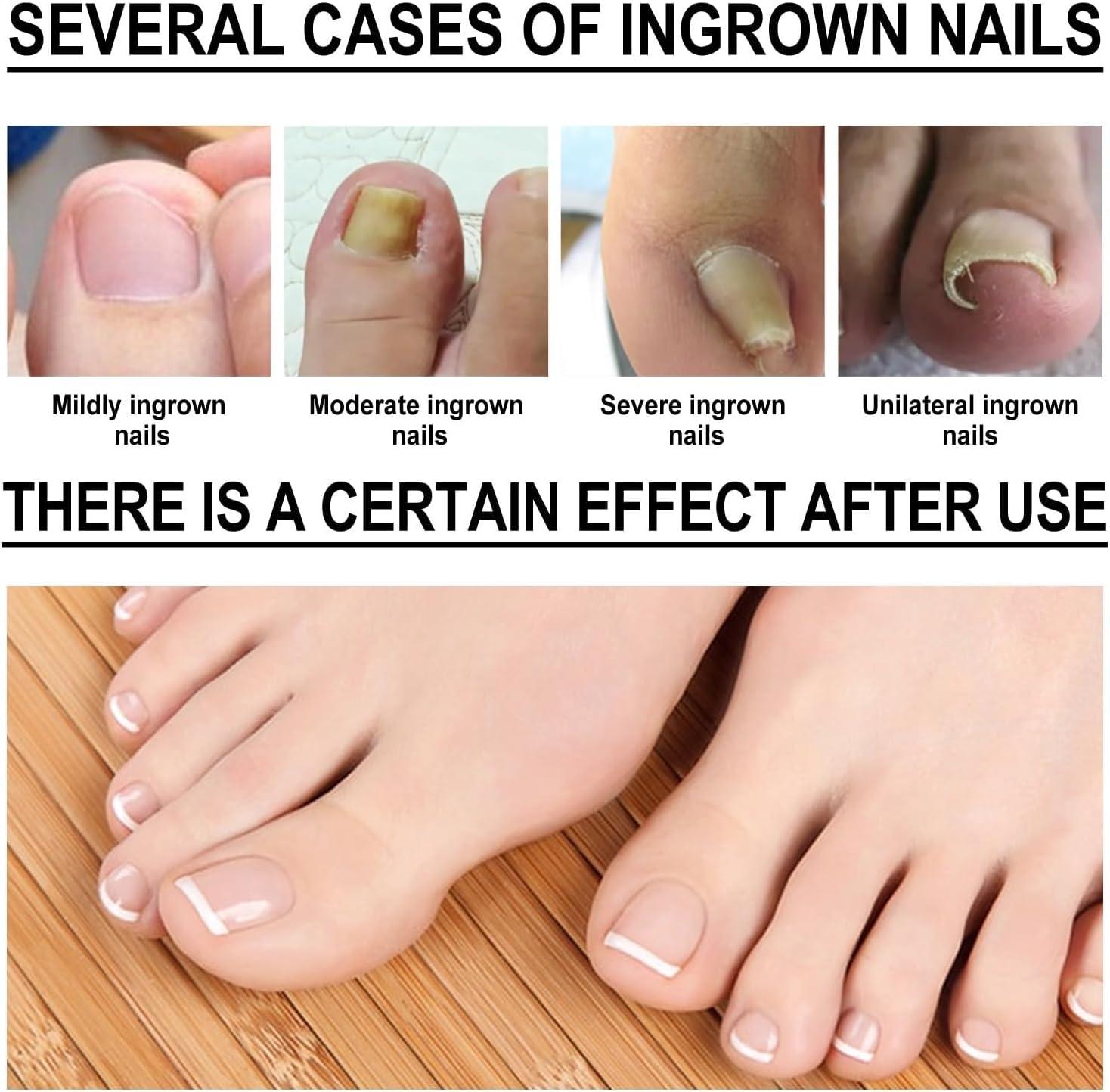 VIDIND Ingrown Toenail Correction Oil Ingrown Toenail Correction Drops ...