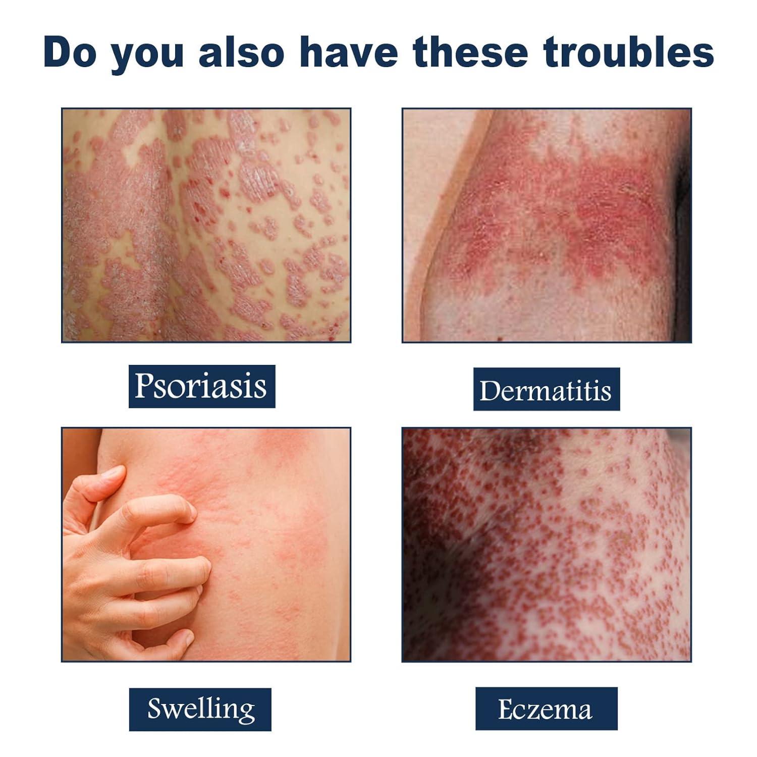 Skin Smart Eczema Therapy Spray by Dermeleve - Steroid-Free Itch Relief Cream (1PC) | Buy Now ...