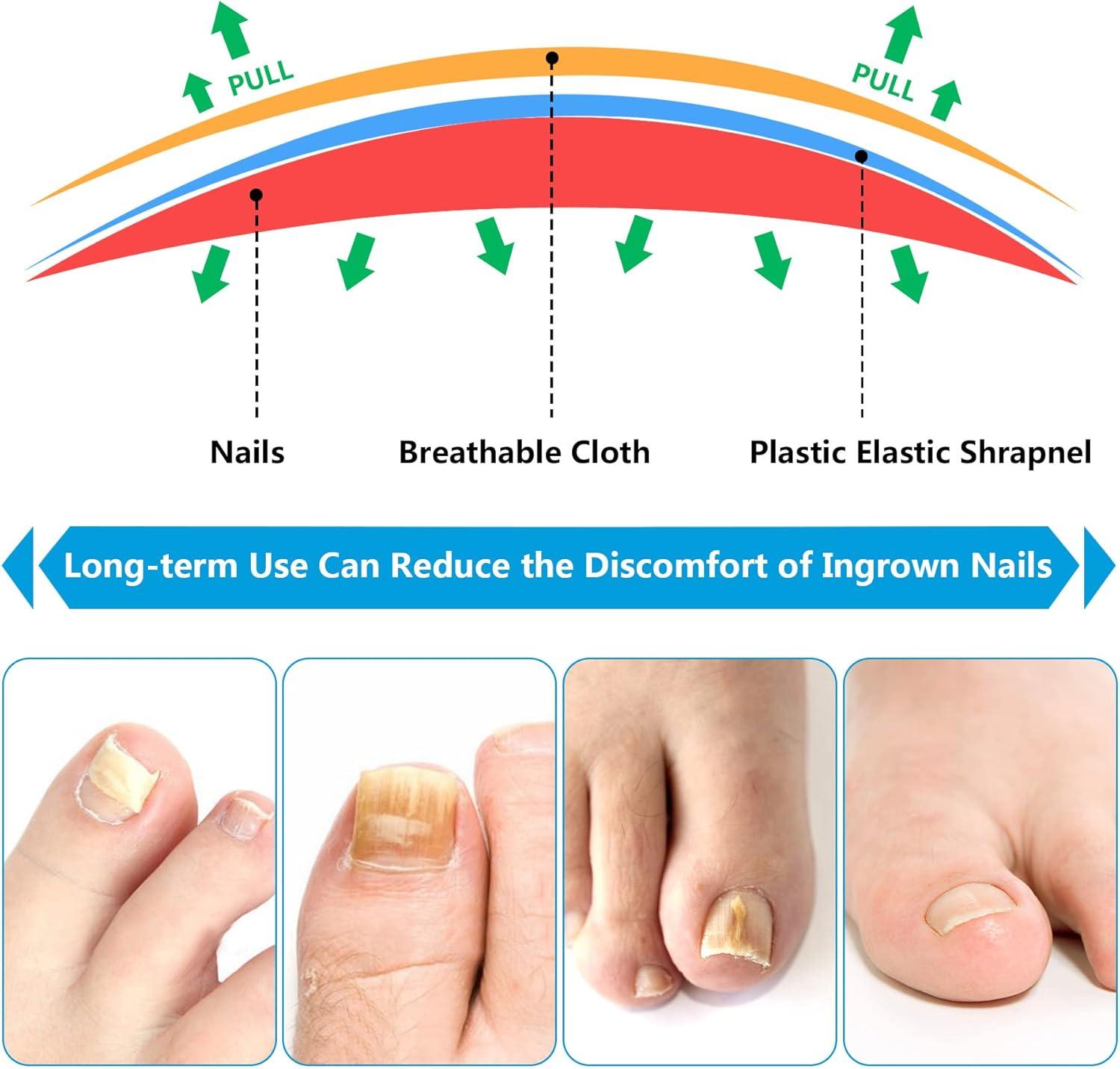 SANNIX Ingrown Toenail Tool Set with 100 Pieces Correction Patches ...