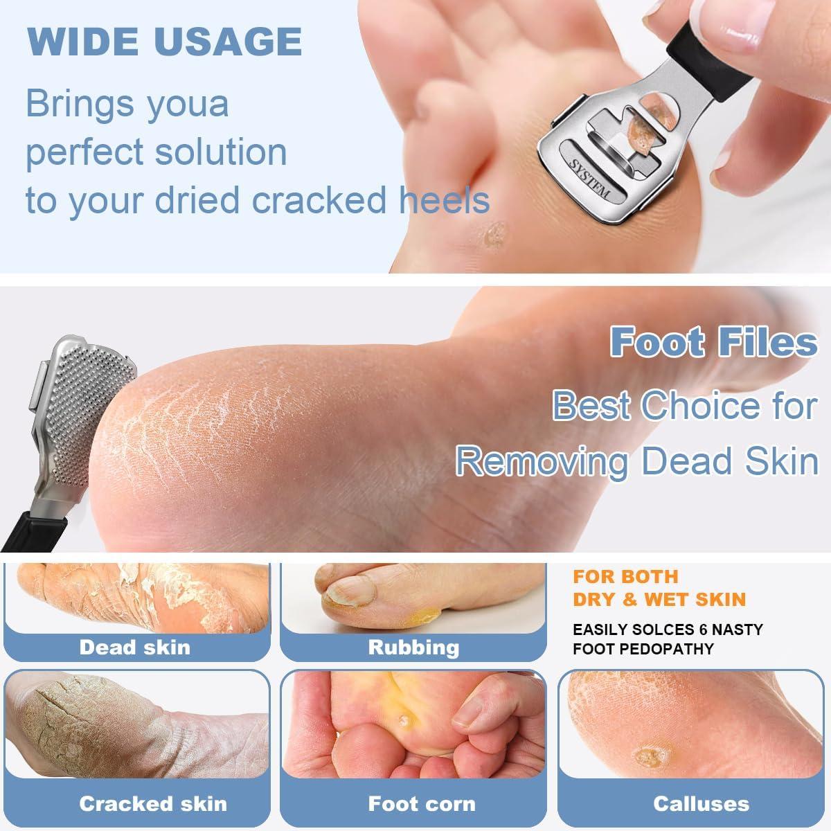 callus removal uk