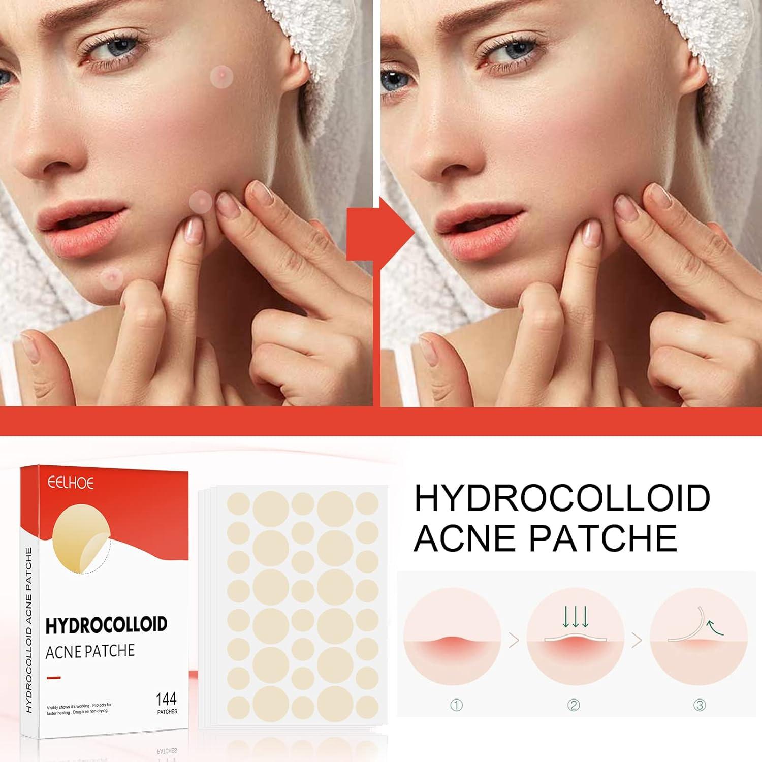 Hydrocolloid Acne Patches - 144 Invisible Spot Patches for Face & Body ...