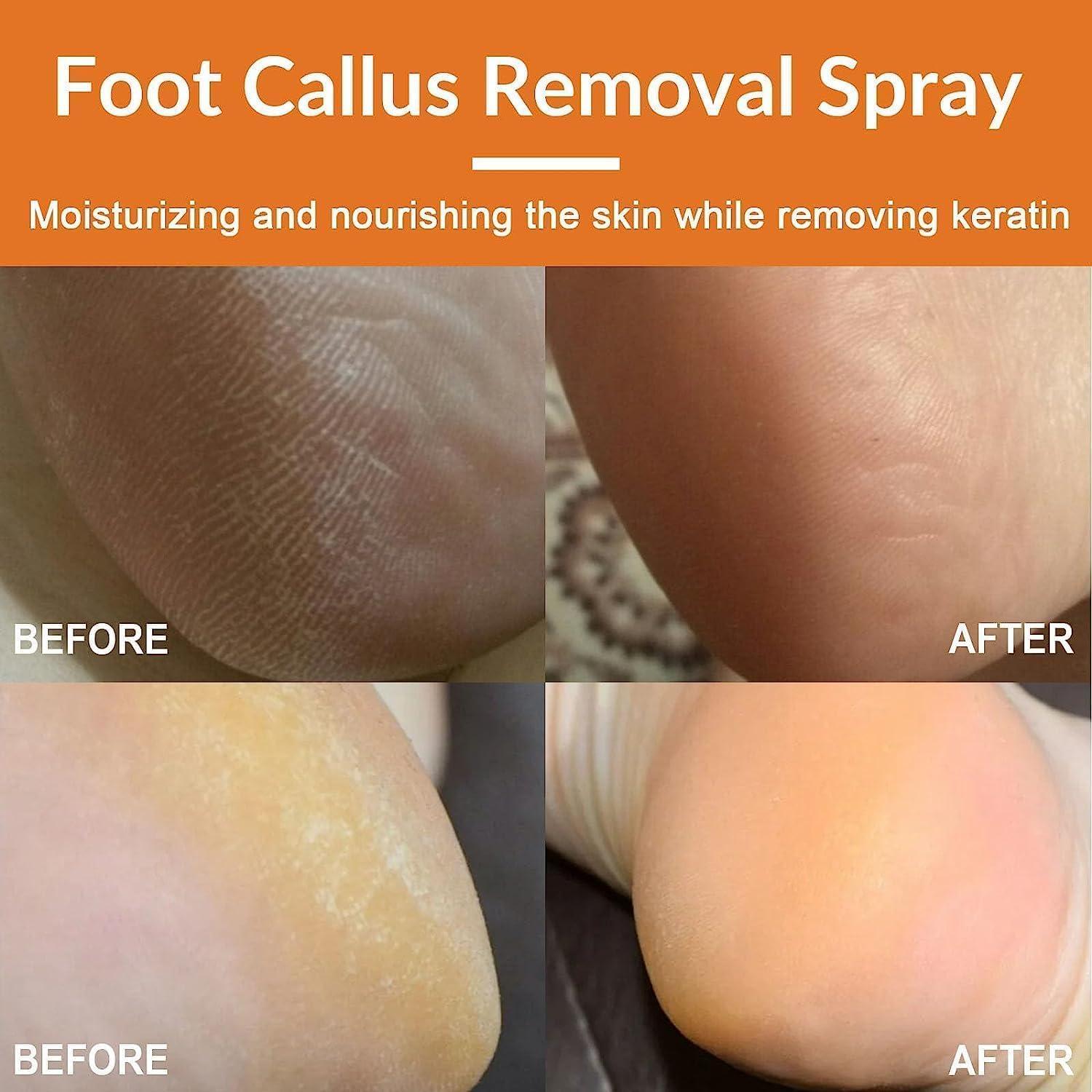 2PC Foot Callus Removal Spray - Instant Dead Skin & Callus Peeling with ...