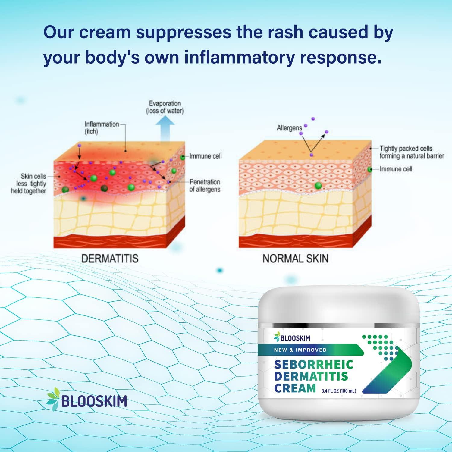 Seborrheic Dermatitis Cream - Fast-Acting Treatment for Face, Scalp ...