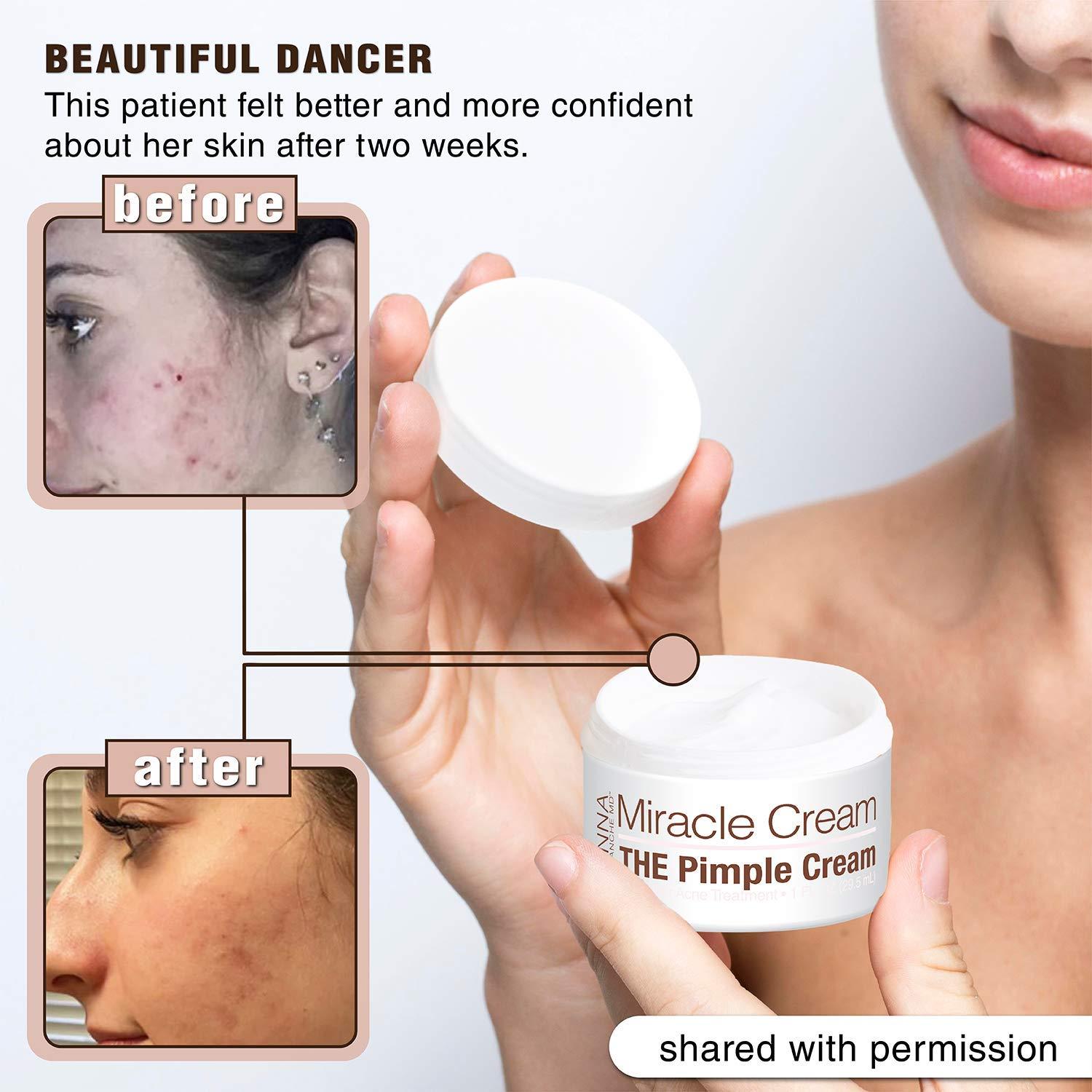 Anna Guanche MD Miracle Cream - Fast-acting Acne Treatment for Pimples ...
