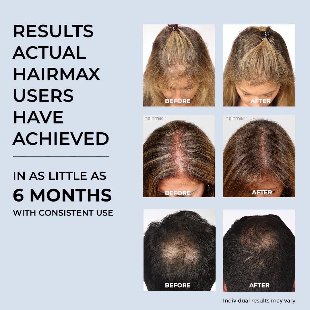 Hairmax ULTIMA 12 Classic Laser Comb for Hair Growth | FDA Cleared ...