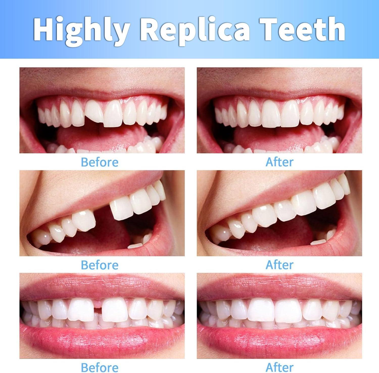 Temporary Tooth Filling Repair Kit - Instant Tooth Filler for Broken ...