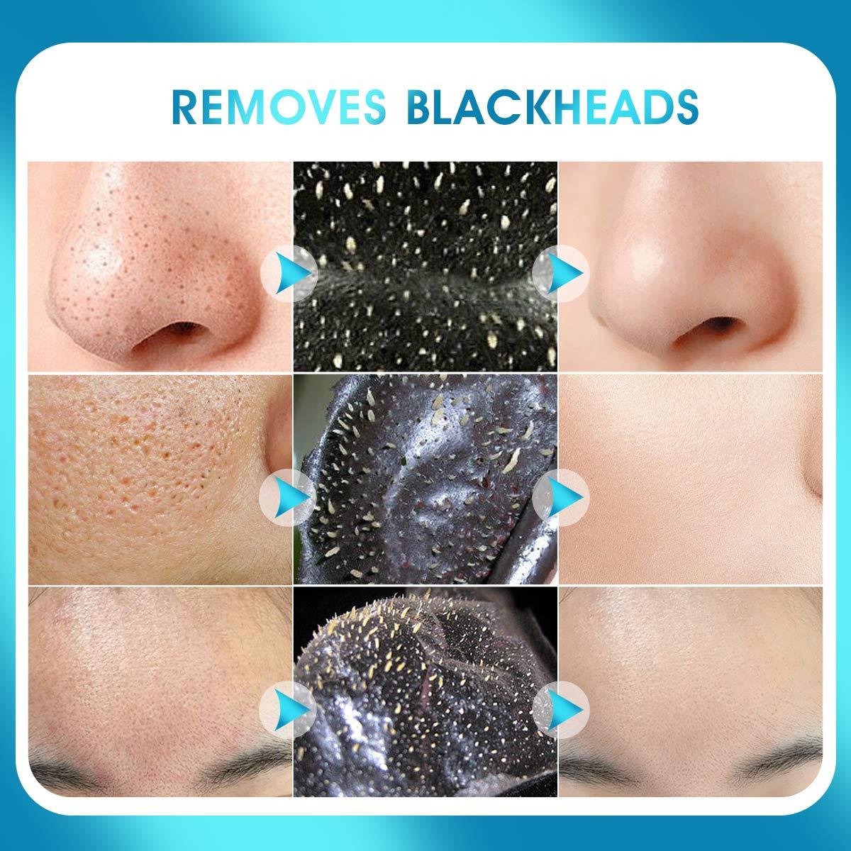 Blackhead Removal Mask 3.5oz with Bamboo Charcoal & Extractor Tools Kit ...