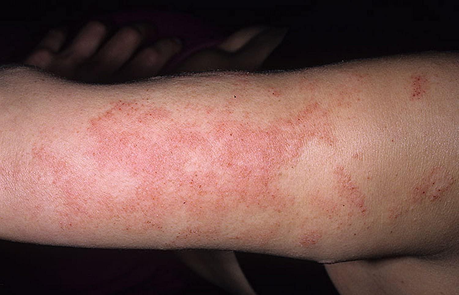 Caladryl Lotion - Soothing Relief for Burns, Bug Bites, and Skin ...