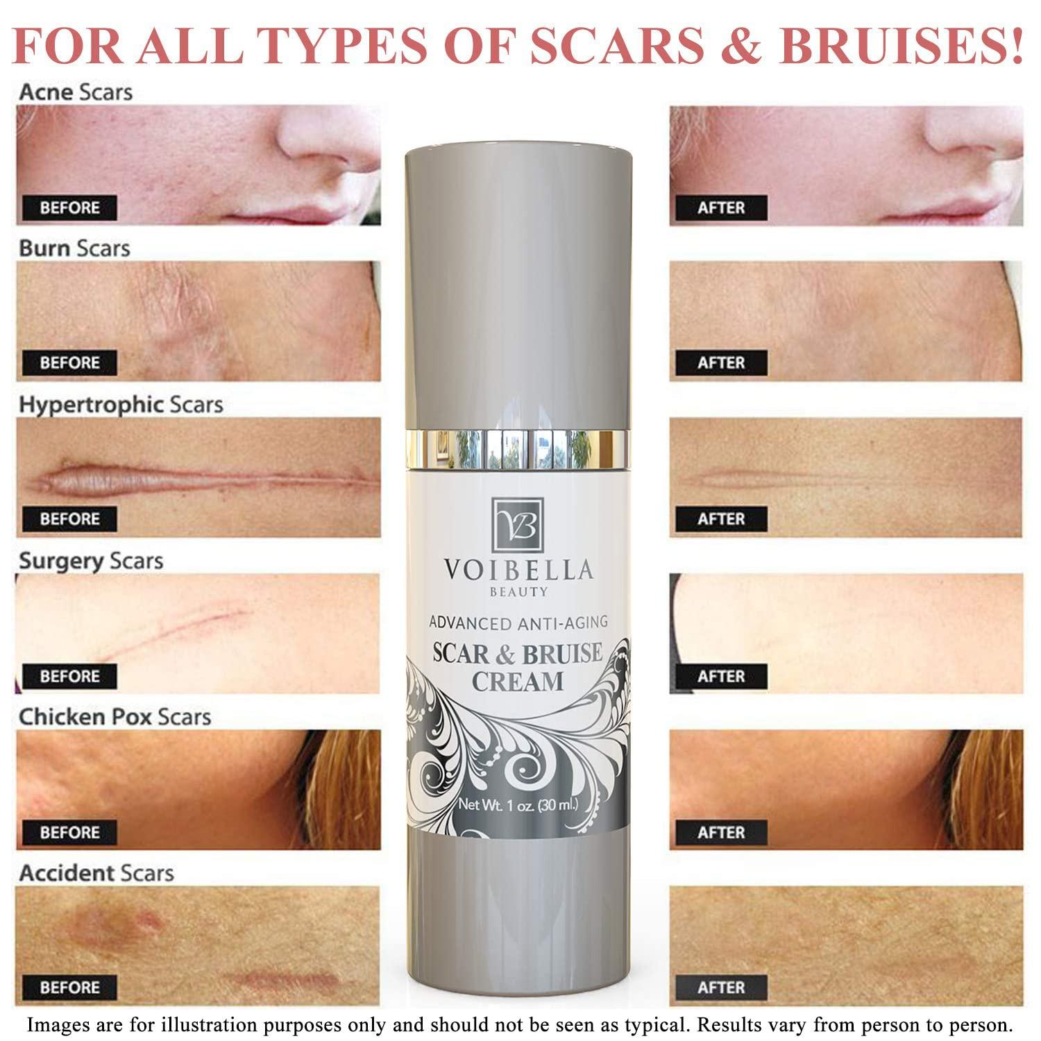 Scar & Bruise Cream - Refine Skin Appearance, Fade Surgical Keloid ...