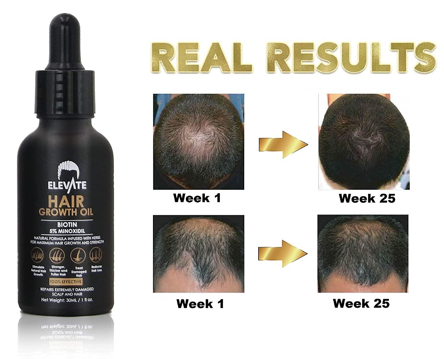 Elevate Hair Growth Oil Biotin And Minoxidil Treatment For Stronger