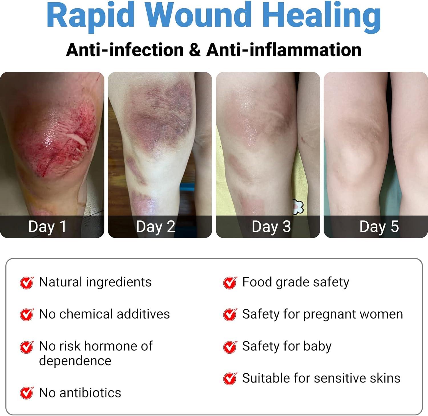 LMNOOP Wound Healing Ointment 1.76oz - Chronic Wound Care for Ulcers, Burns, Cuts - Pain Relief ...