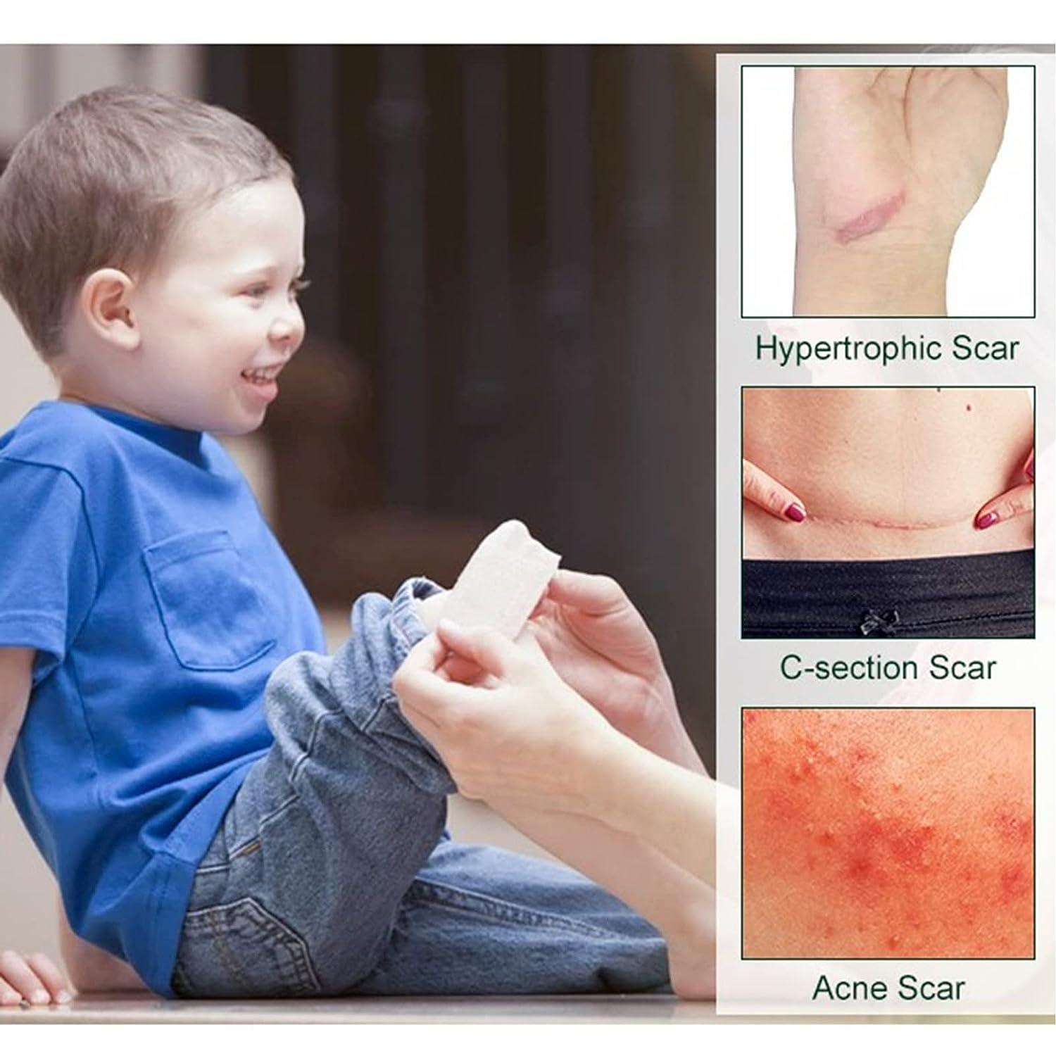 Moisturizing Silicone Scar Sheets - Reusable & Self-Adhesive Stretchy ...