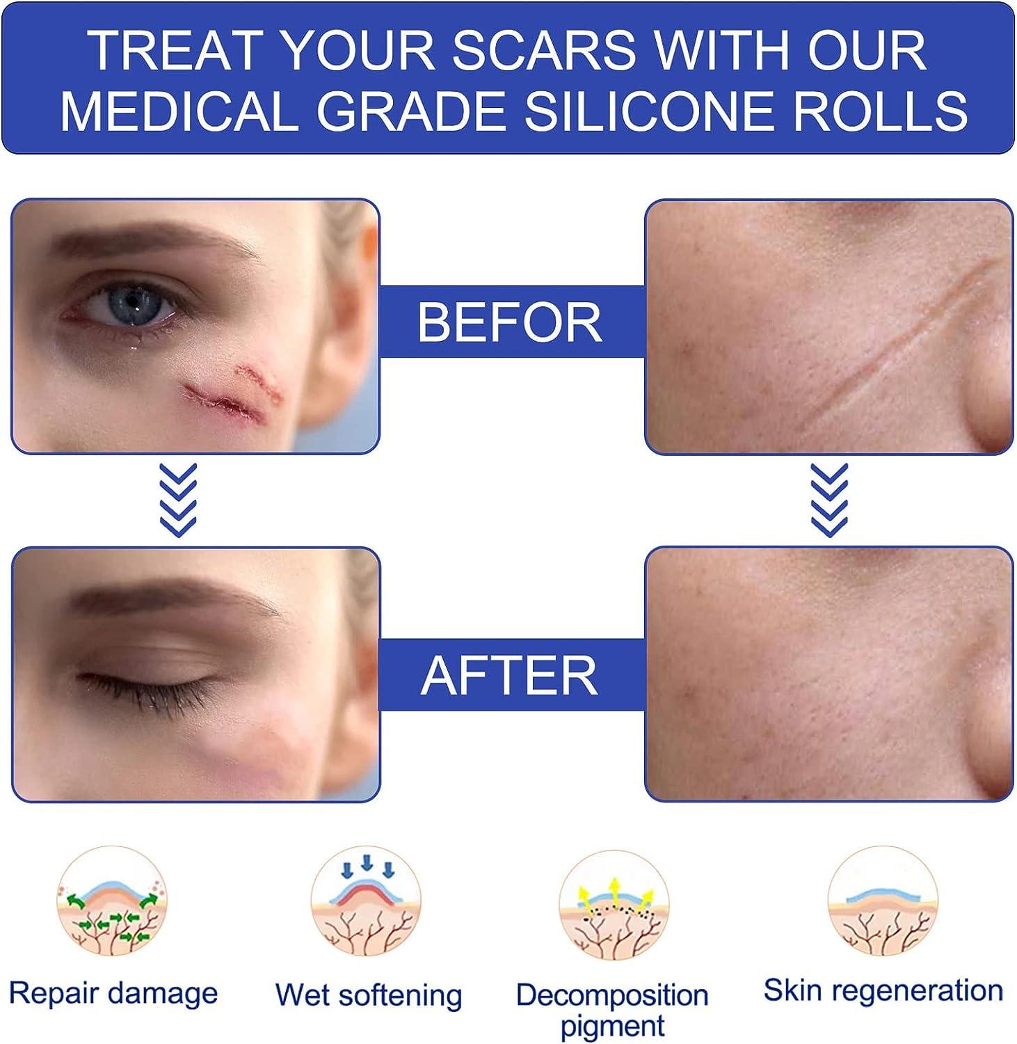 3 Meter Silicone Scar Tape Gel Repair Sticker for Scalds, Burns, and ...