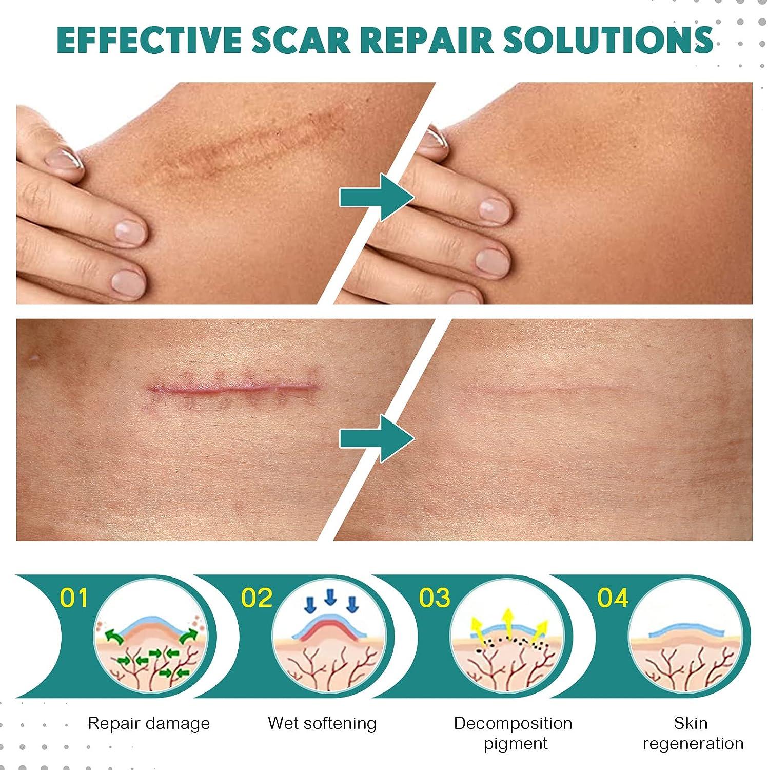 Silicone Scar Tape 1.6 x 60 Roll - Reusable Professional Scar Removal ...