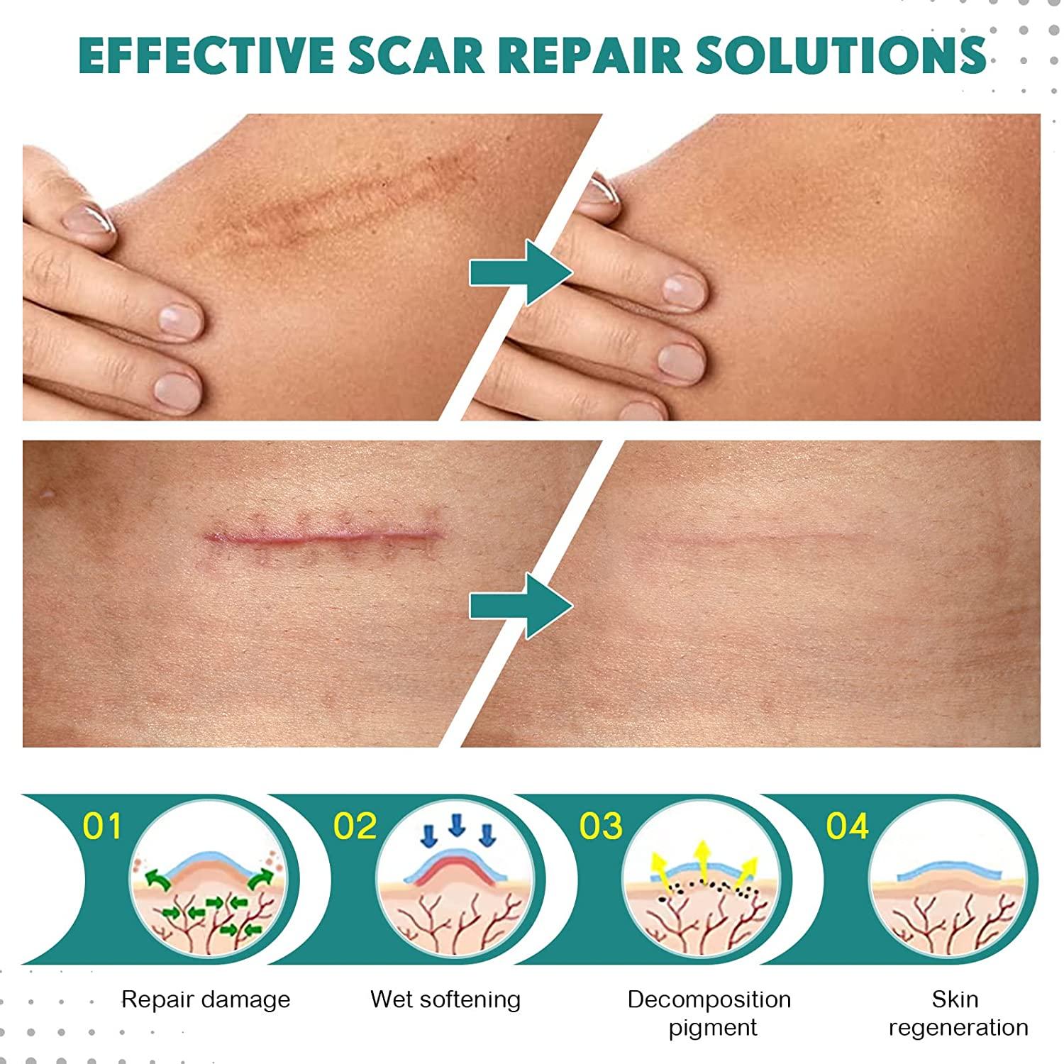 Silicone Scar Sheets & Tape (1.6 x 120 Roll-3M) for Surgical Scars ...