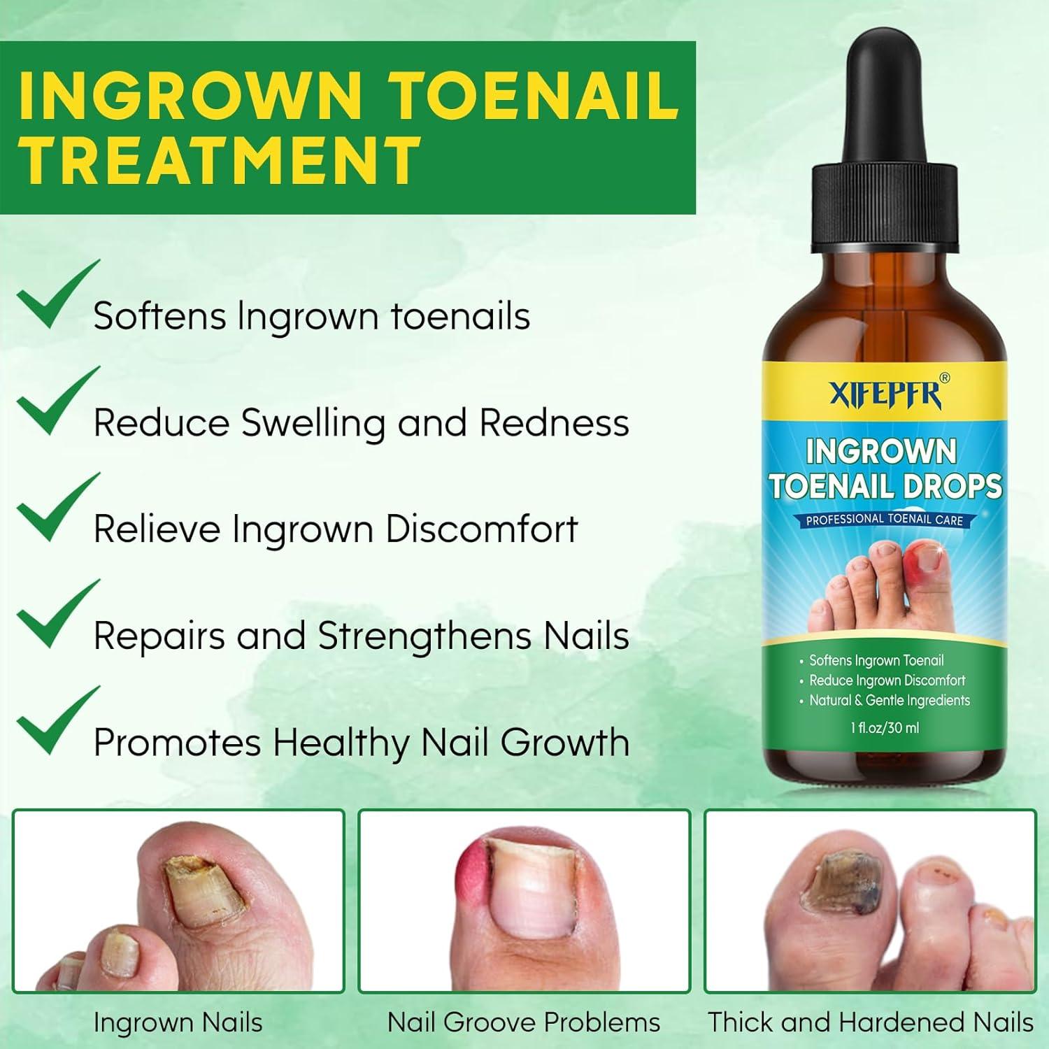 Ingrown Toenail Treatment & Reliever | Easy Trimming & Correction Drops ...