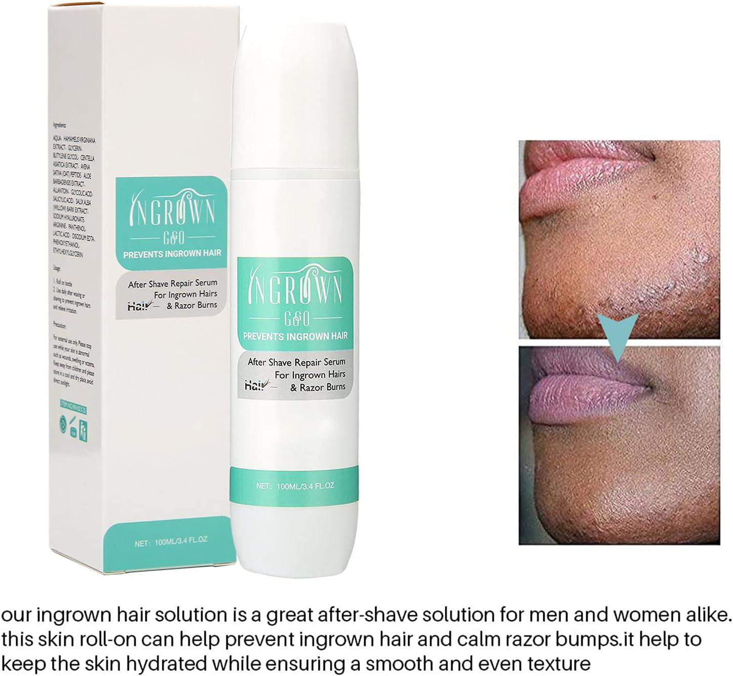 Razor Bumps Solution: 100ml Roll-on After Shave Repair Serum for Men ...