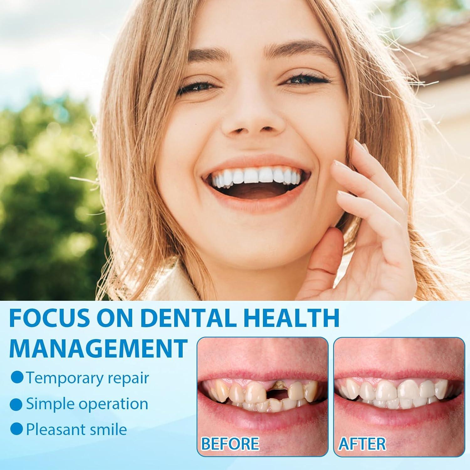 Temporary Tooth Filling Tooth Repair Kit with Tweezers DIY Temporary ...