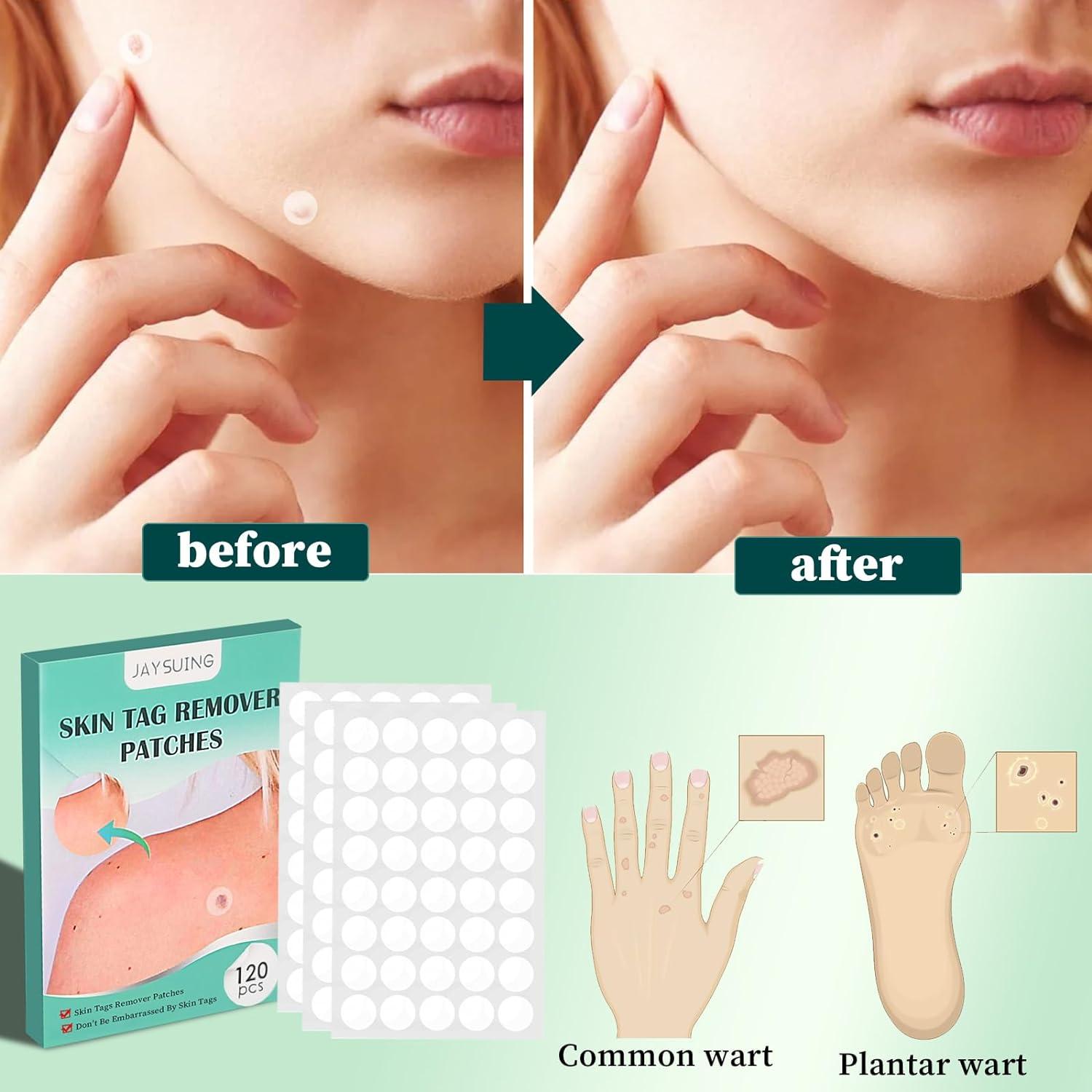 Skin Tag & Mole Removal Patches - 120 PCS Wart Treatment Stickers | Buy ...