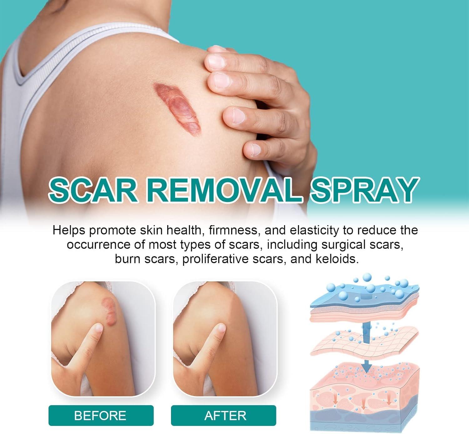 Nihexo 20g Medical Grade Scar Spray - Effective Scar Removal Treatment ...