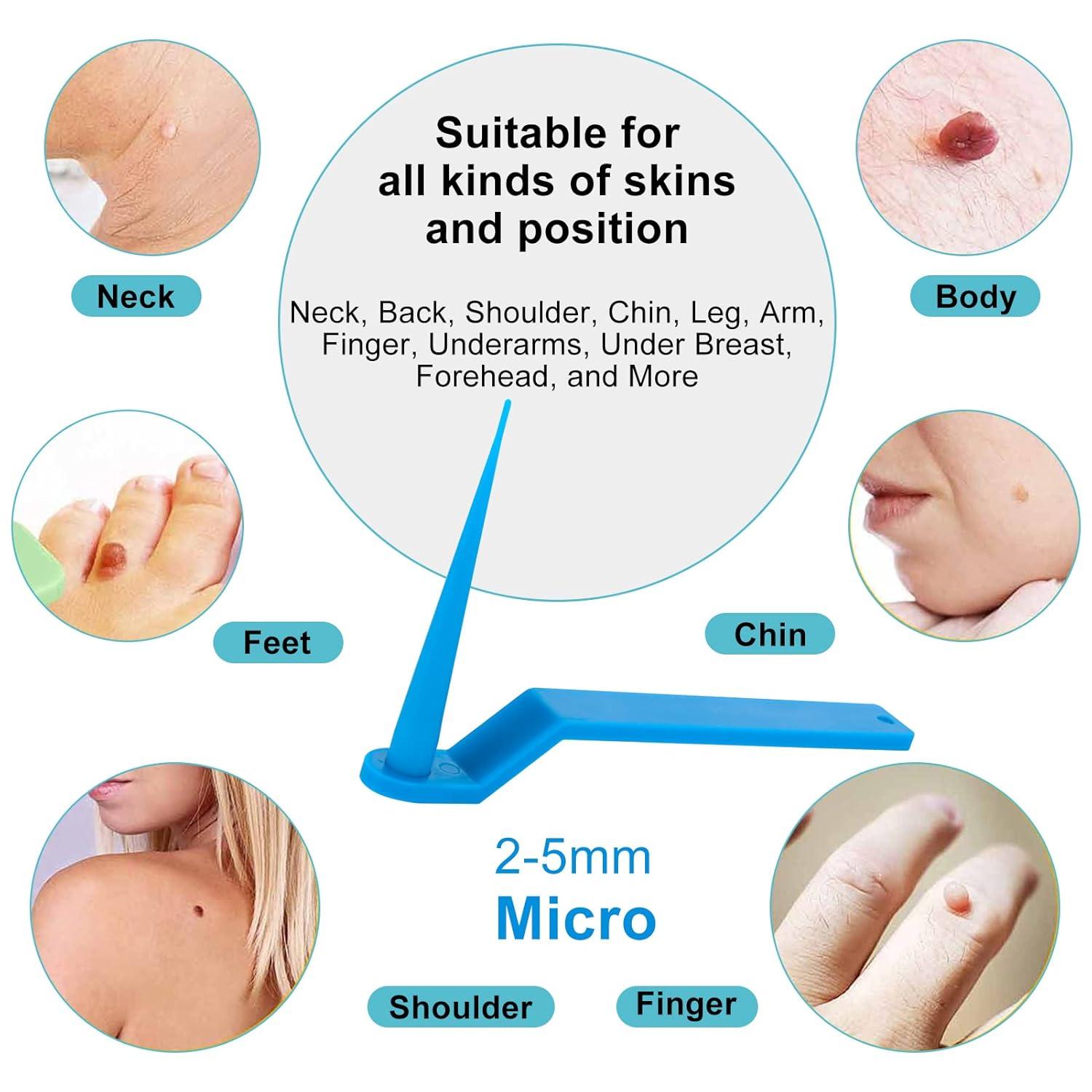 116 Pcs Skin Tag & Wart Removal Patch Kit - Quick & Effective Solution ...