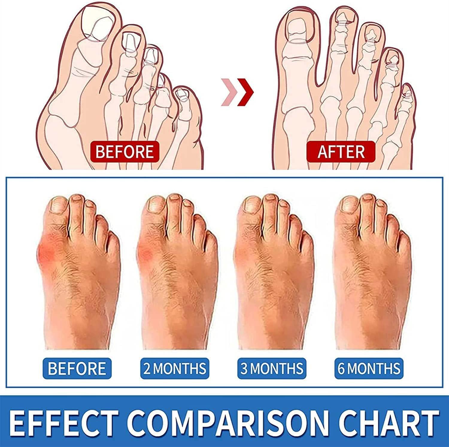 OBODN 6 Pcs Orthopedic Bunion Corrector Splint Toe Separator & Pain ...