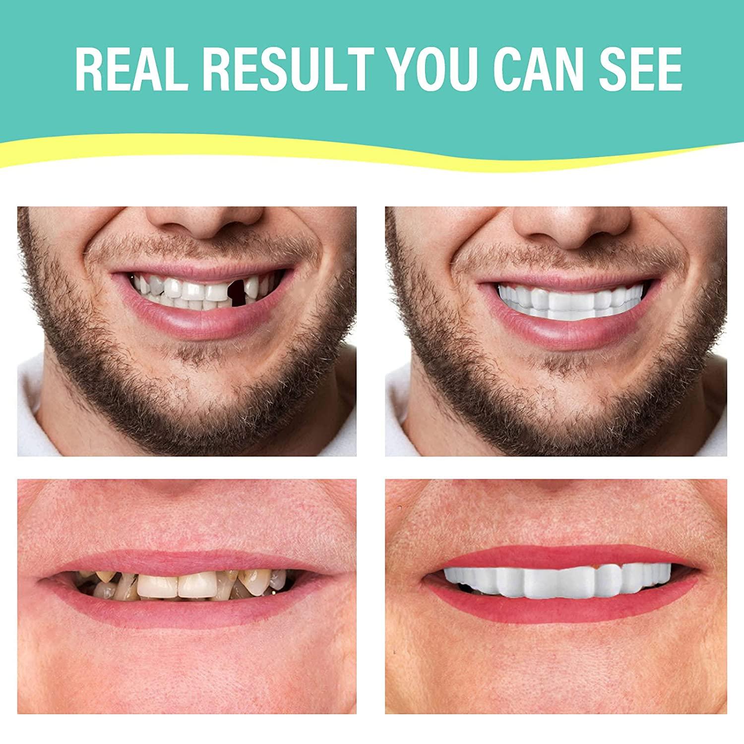 2 Packs Fake Teeth, Dental Veneers for Upper and Lower Jaw , Veneers ...