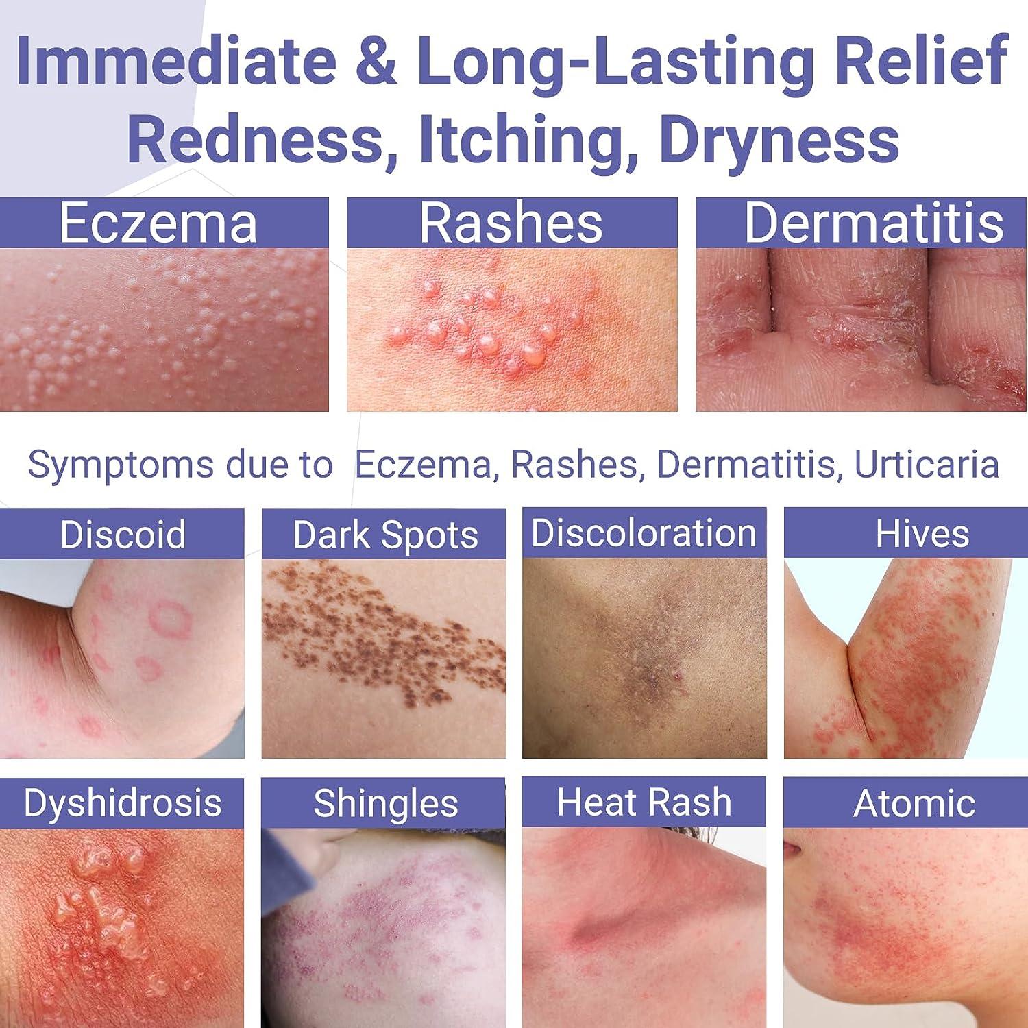 Ishancare Eczema Cream Maximum Treatment Ointment - Fast Relief for Eczema Rash, Dermatitis ...